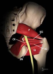 Ischiofemoral Impingement Syndrome Radsource Ischiofemoral Impingement Syndrome Radsource