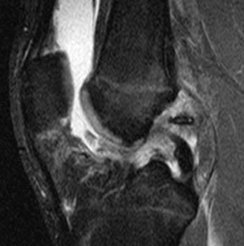 Torn Hamstring X Ray