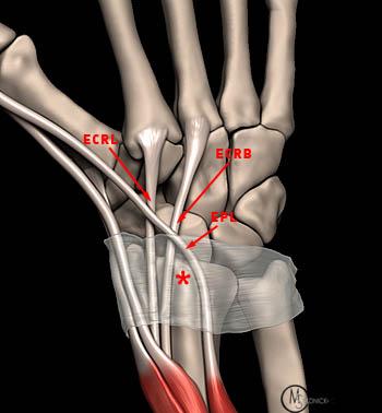 Tendon Intersection Syndromes - Radsource