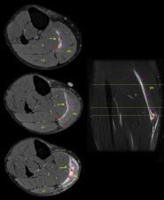 Not The Plantaris Keys To Better Diagnosis Of Calf Strain Injuries