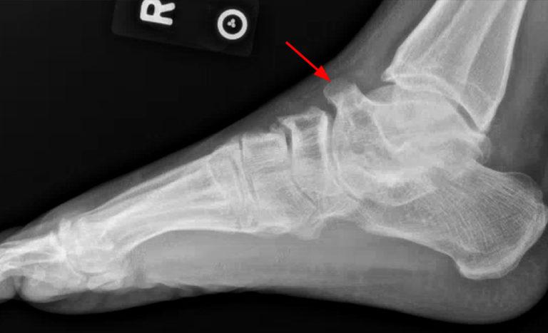 17A - Prominent talar beaks | Radsource