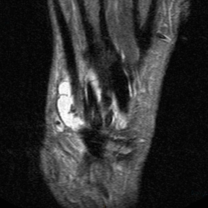 Stenosing Tenosynovitis of the 4th Extensor Compartment | Radsource