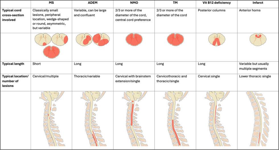 Demyelinating Lesions | Radsource