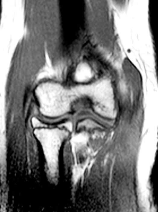 Trochlea Femur Mri