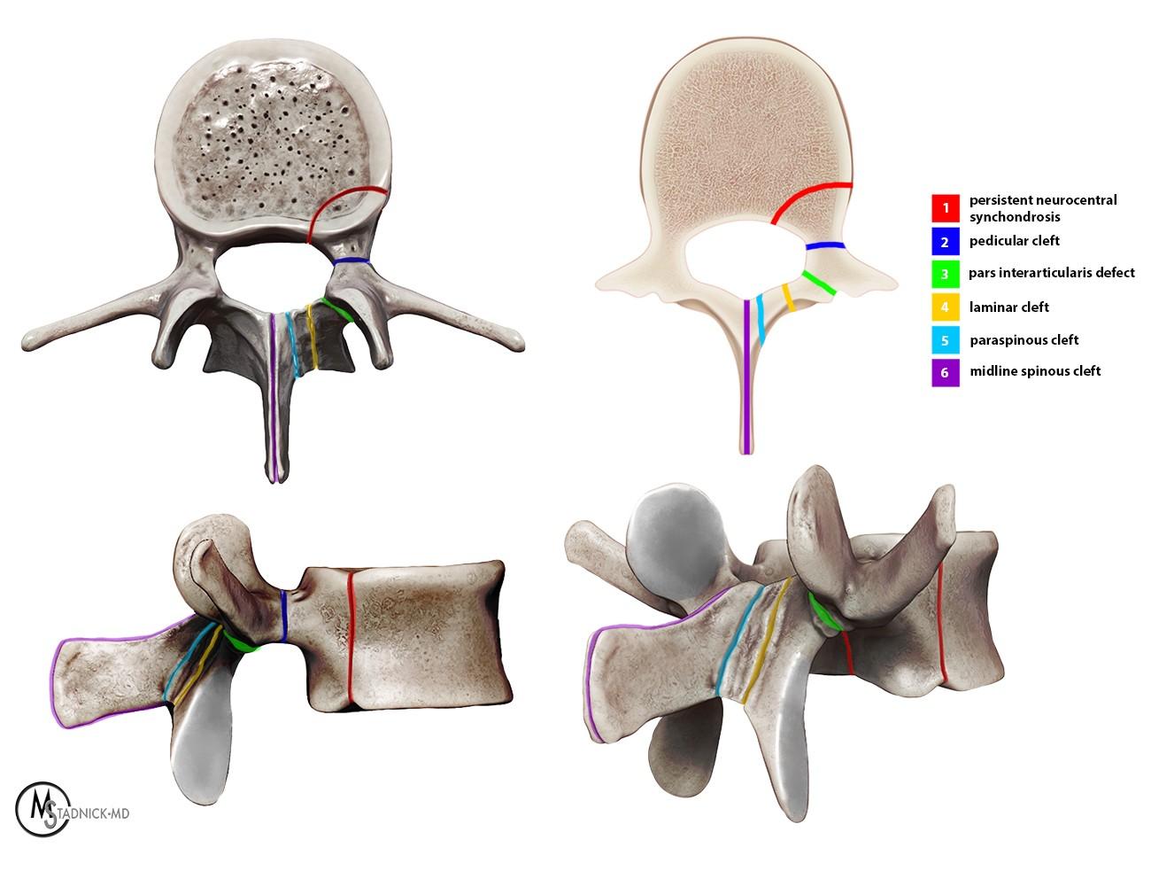 Pediculolysis and Laminolysis | Radsource