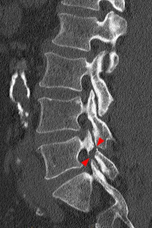Pediculolysis and Laminolysis | Radsource