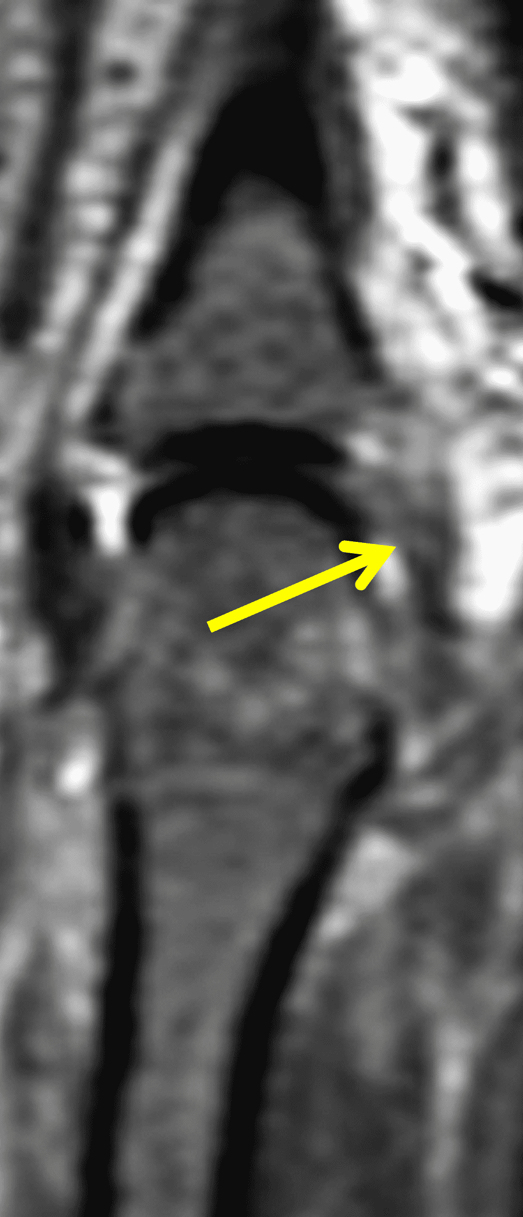 Stener-like Lesions in Musculoskeletal MRI | Radsource