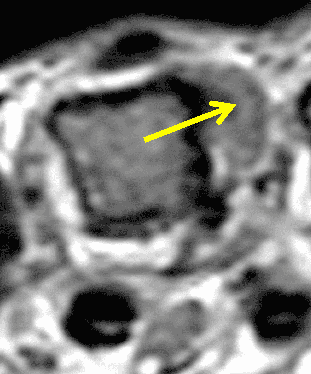 Stener-like Lesions in Musculoskeletal MRI | Radsource