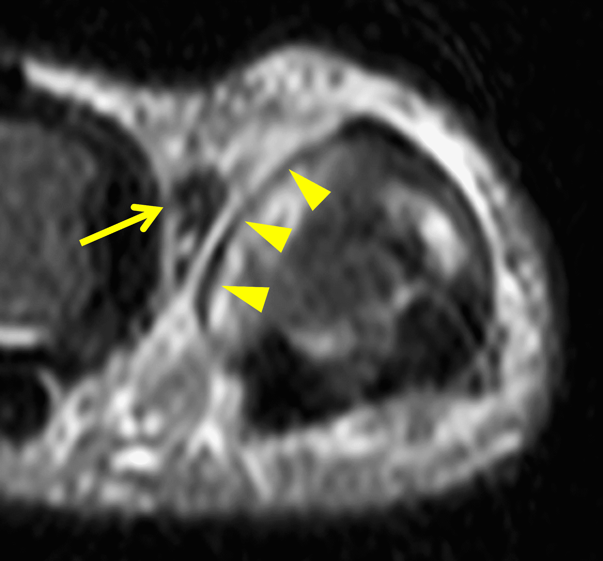 Stener-like Lesions in Musculoskeletal MRI | Radsource