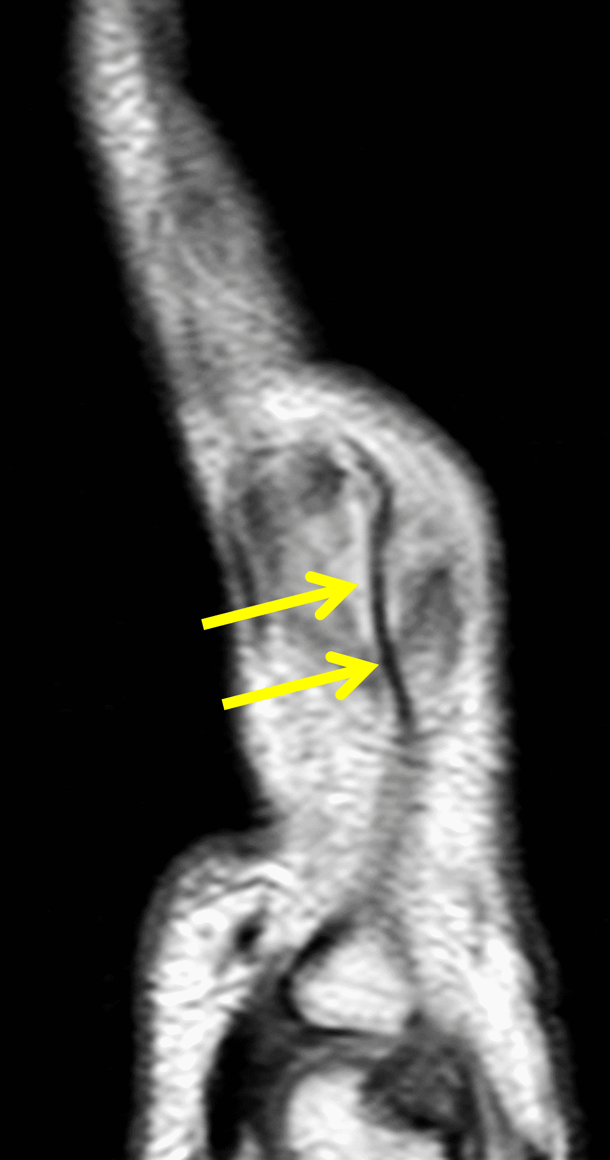 Stener-like Lesions in Musculoskeletal MRI | Radsource