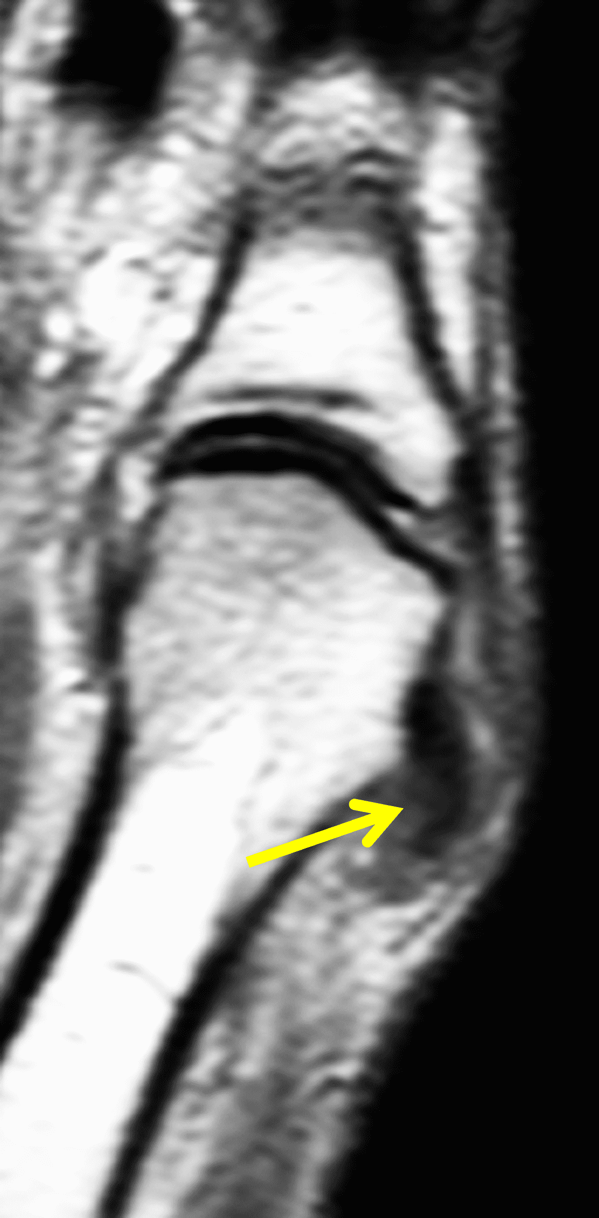 Stener-like Lesions in Musculoskeletal MRI | Radsource