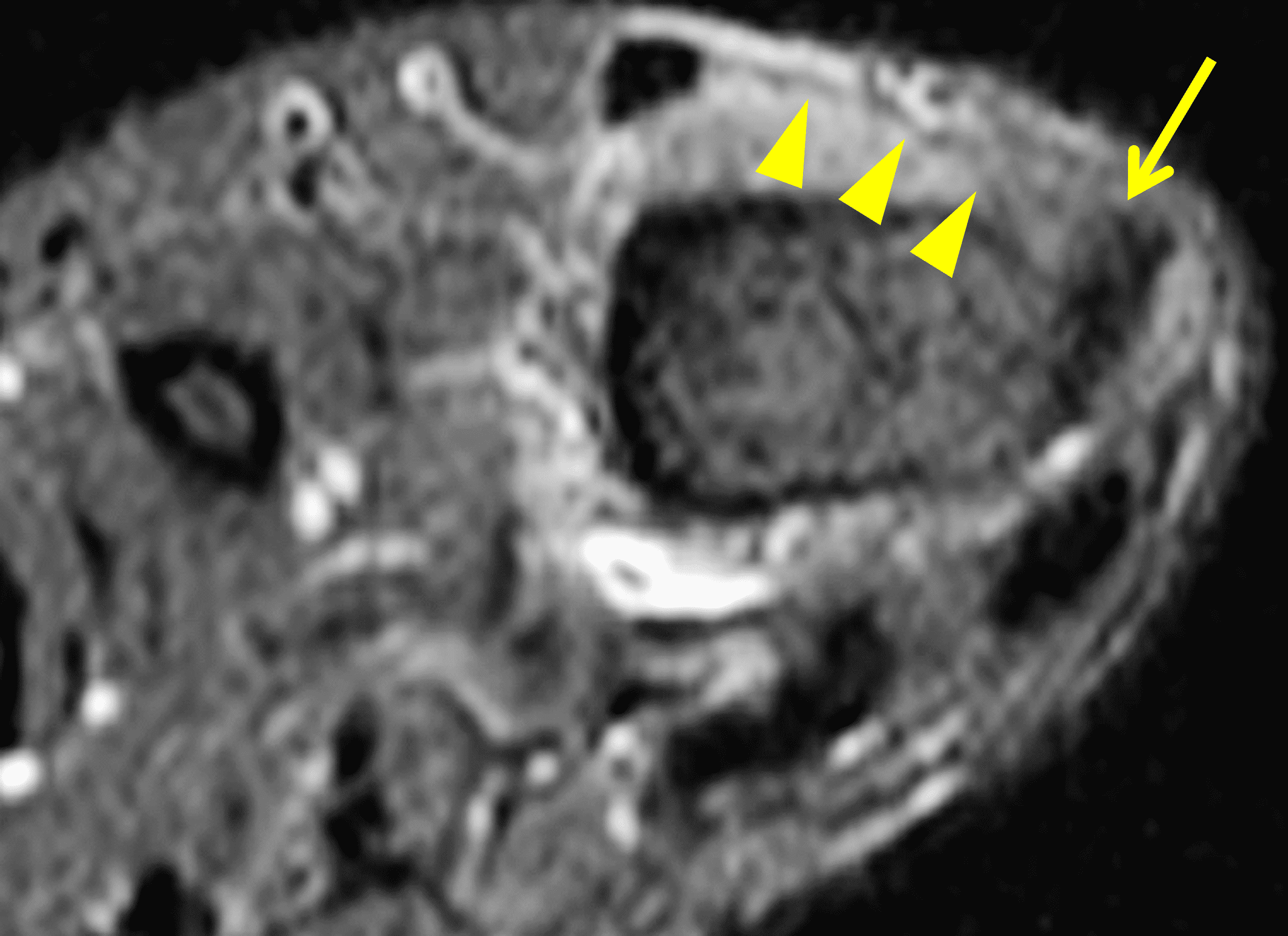 Stener-like Lesions in Musculoskeletal MRI | Radsource