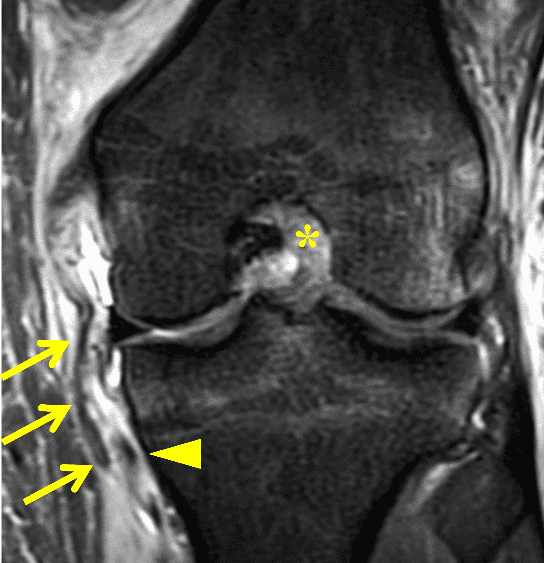Stener-like Lesions in Musculoskeletal MRI | Radsource