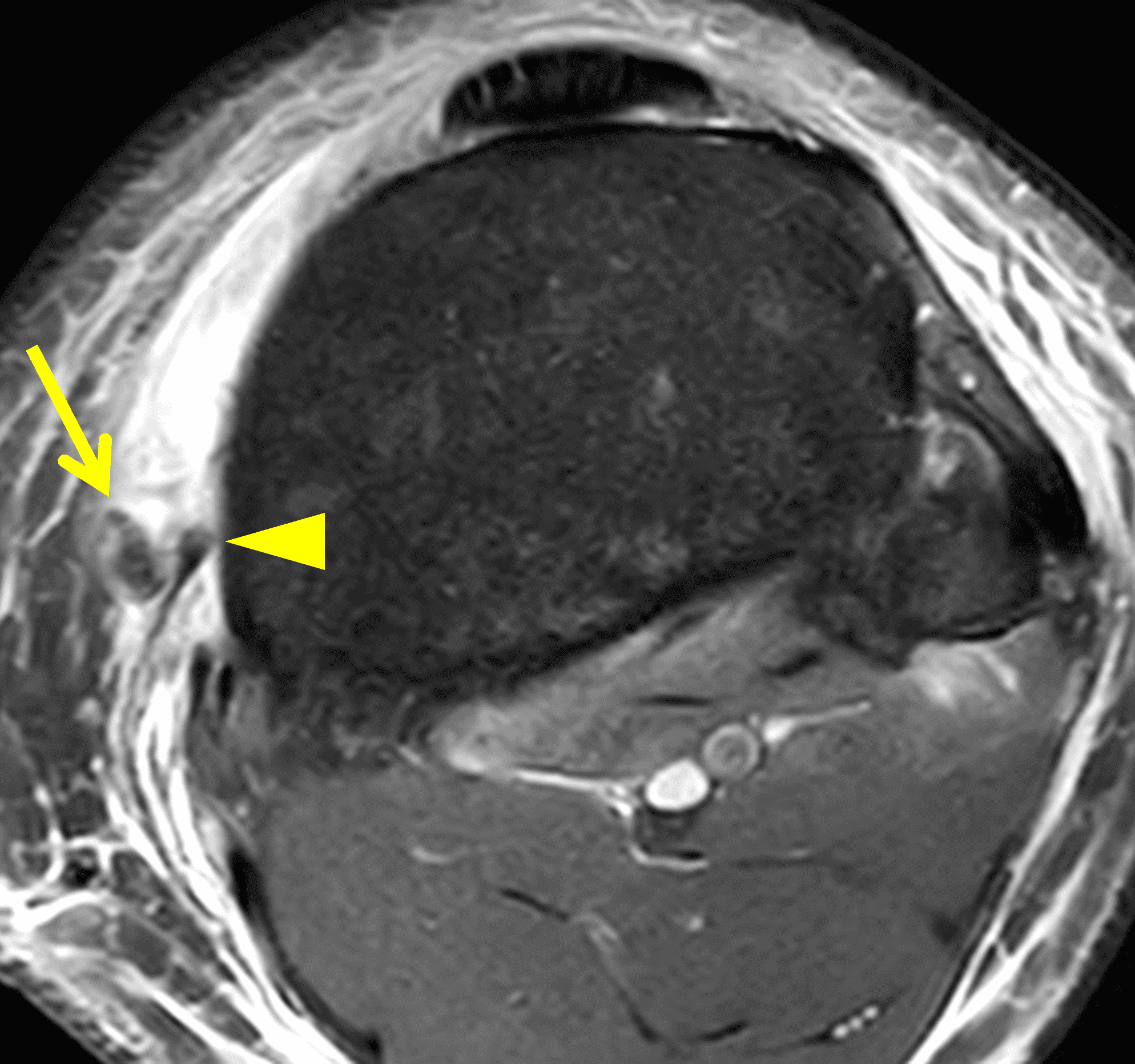 Stener-like Lesions in Musculoskeletal MRI | Radsource