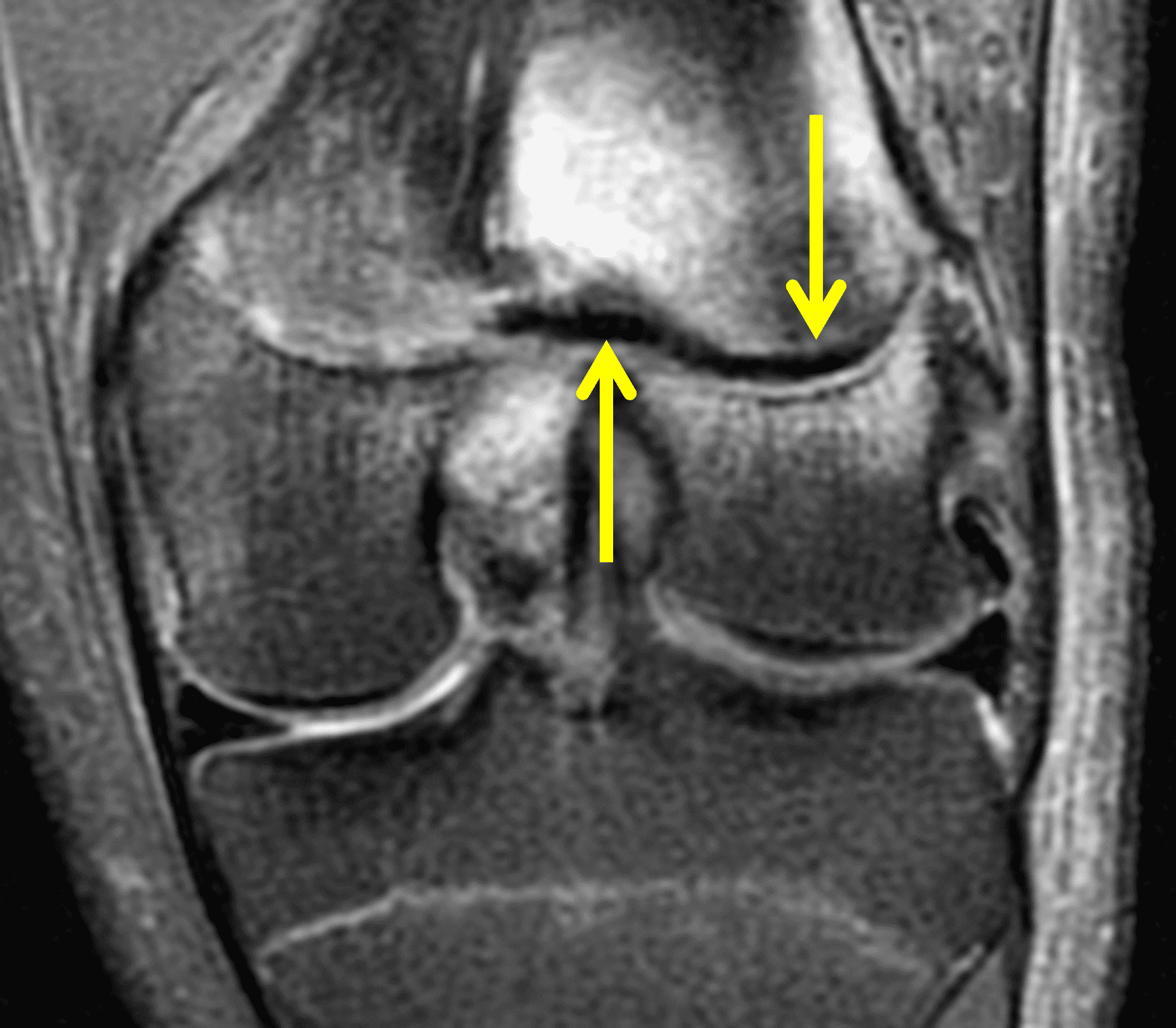 Stener-like Lesions in Musculoskeletal MRI | Radsource