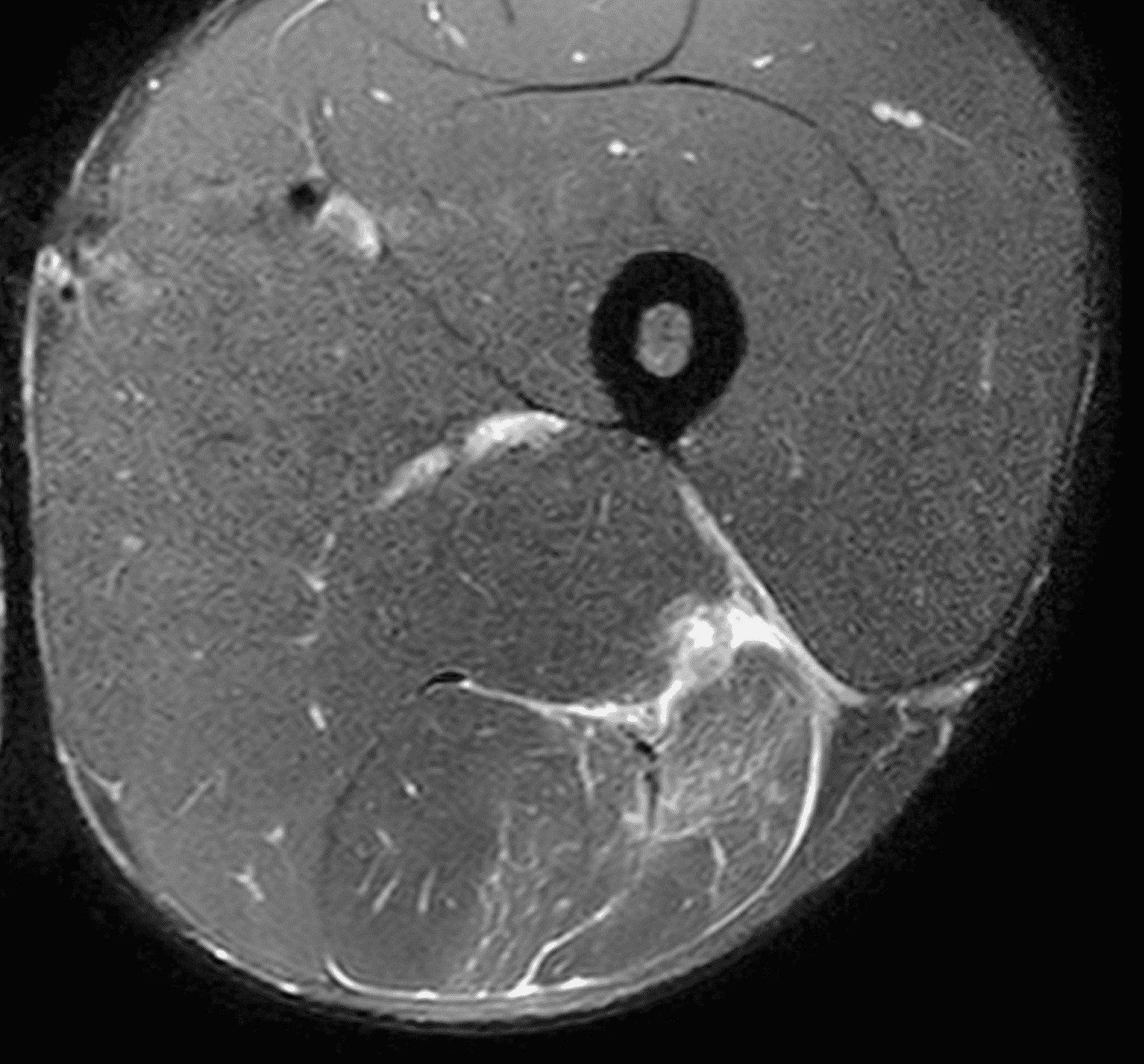 Grading Hamstring Injuries using the British Athletics Muscle Injury ...