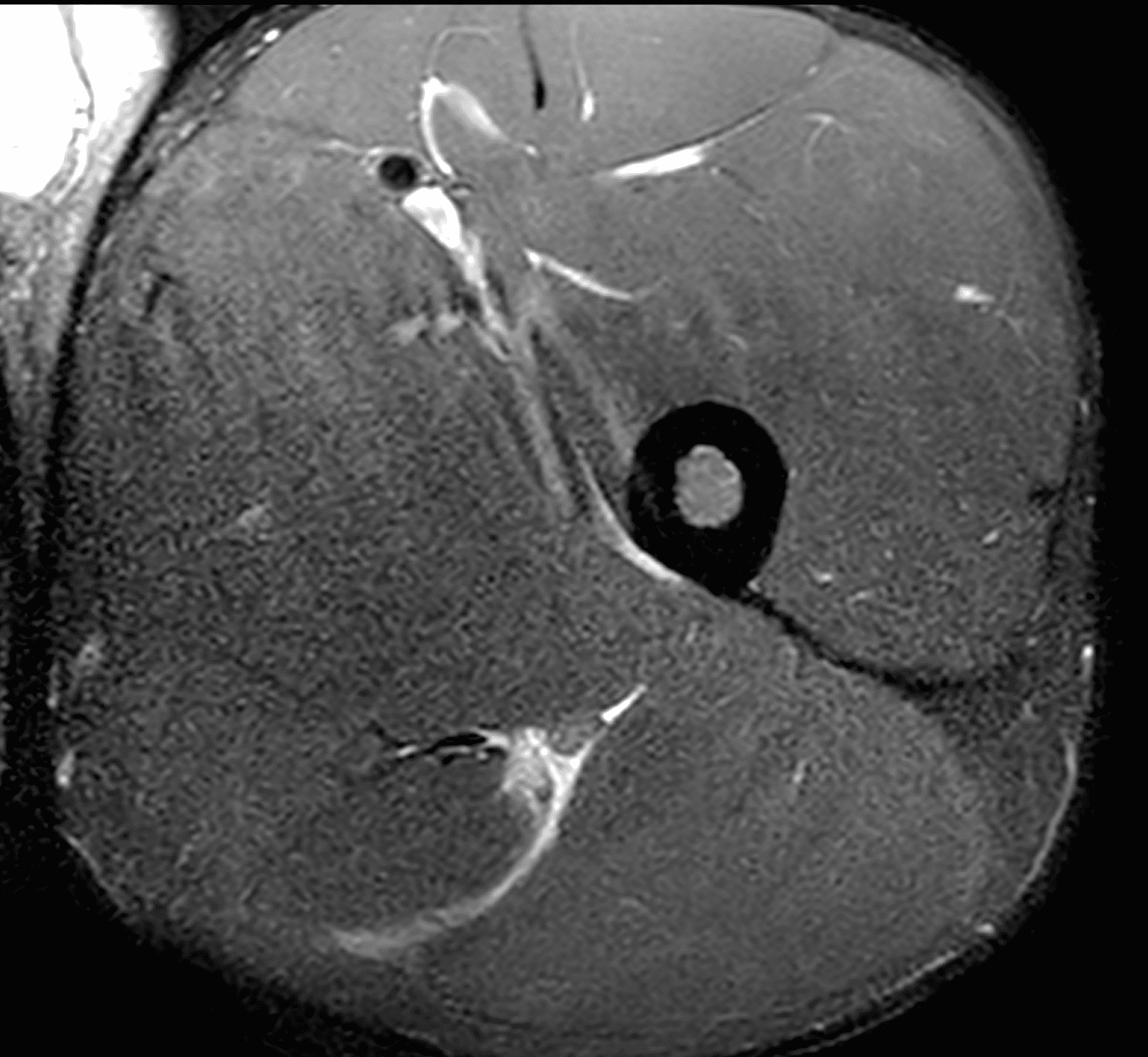 Grading Hamstring Injuries using the British Athletics Muscle Injury ...