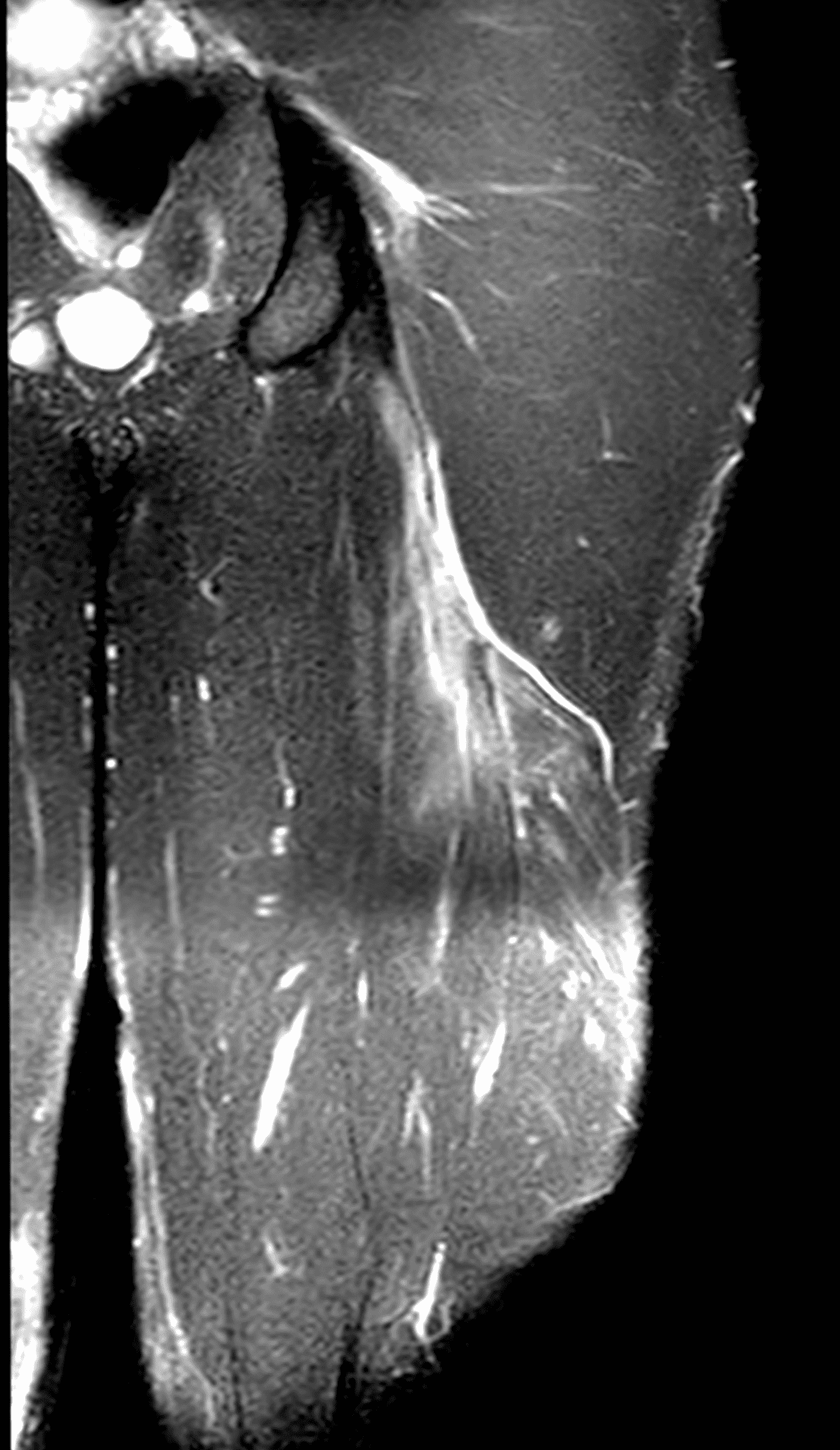 Grading Hamstring Injuries using the British Athletics Muscle Injury ...