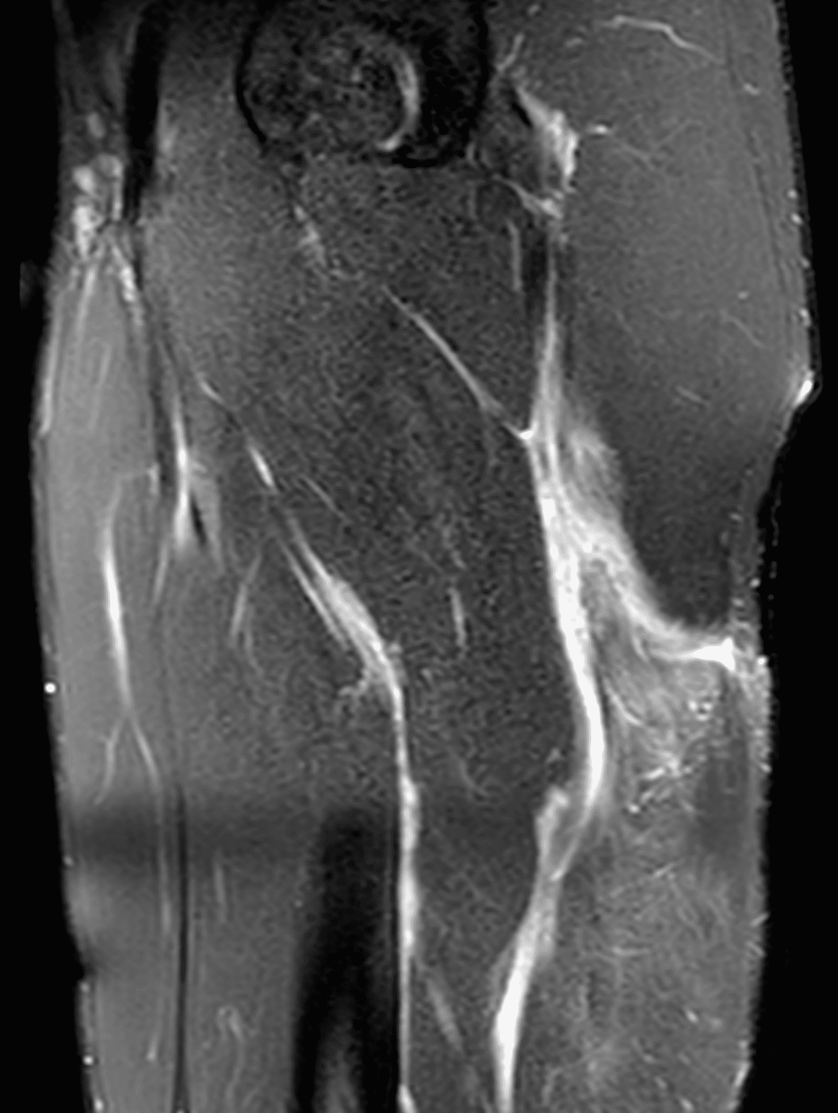 Grading Hamstring Injuries using the British Athletics Muscle Injury ...