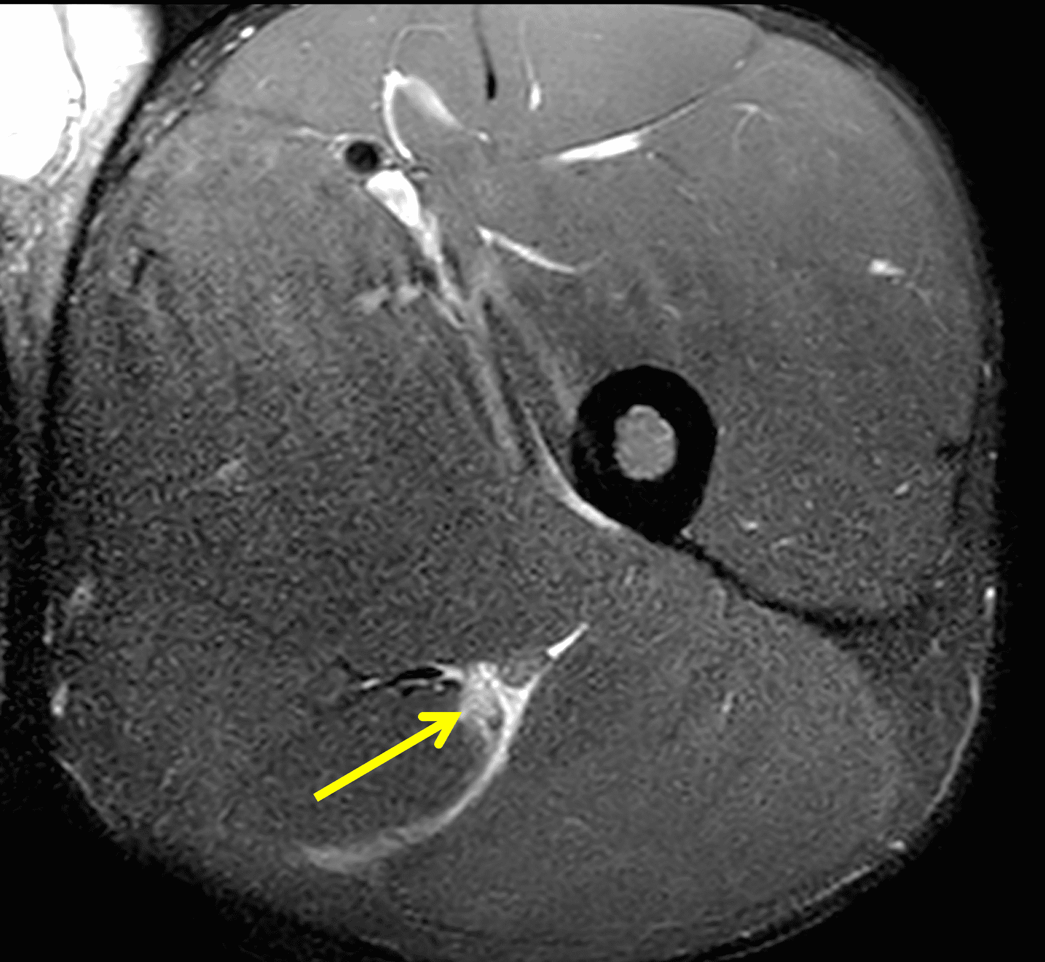 Grading Hamstring Injuries using the British Athletics Muscle Injury ...