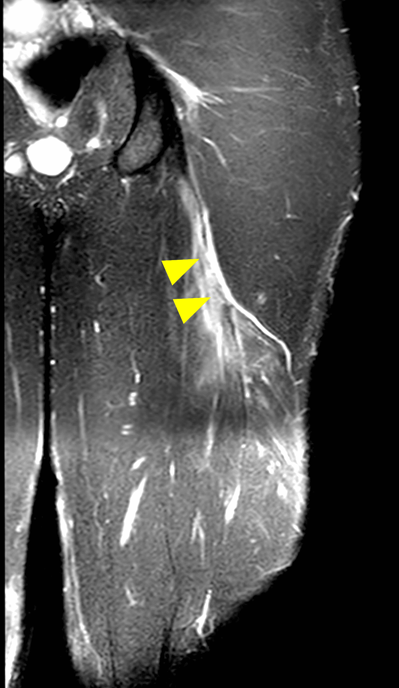 Grading Hamstring Injuries using the British Athletics Muscle Injury ...