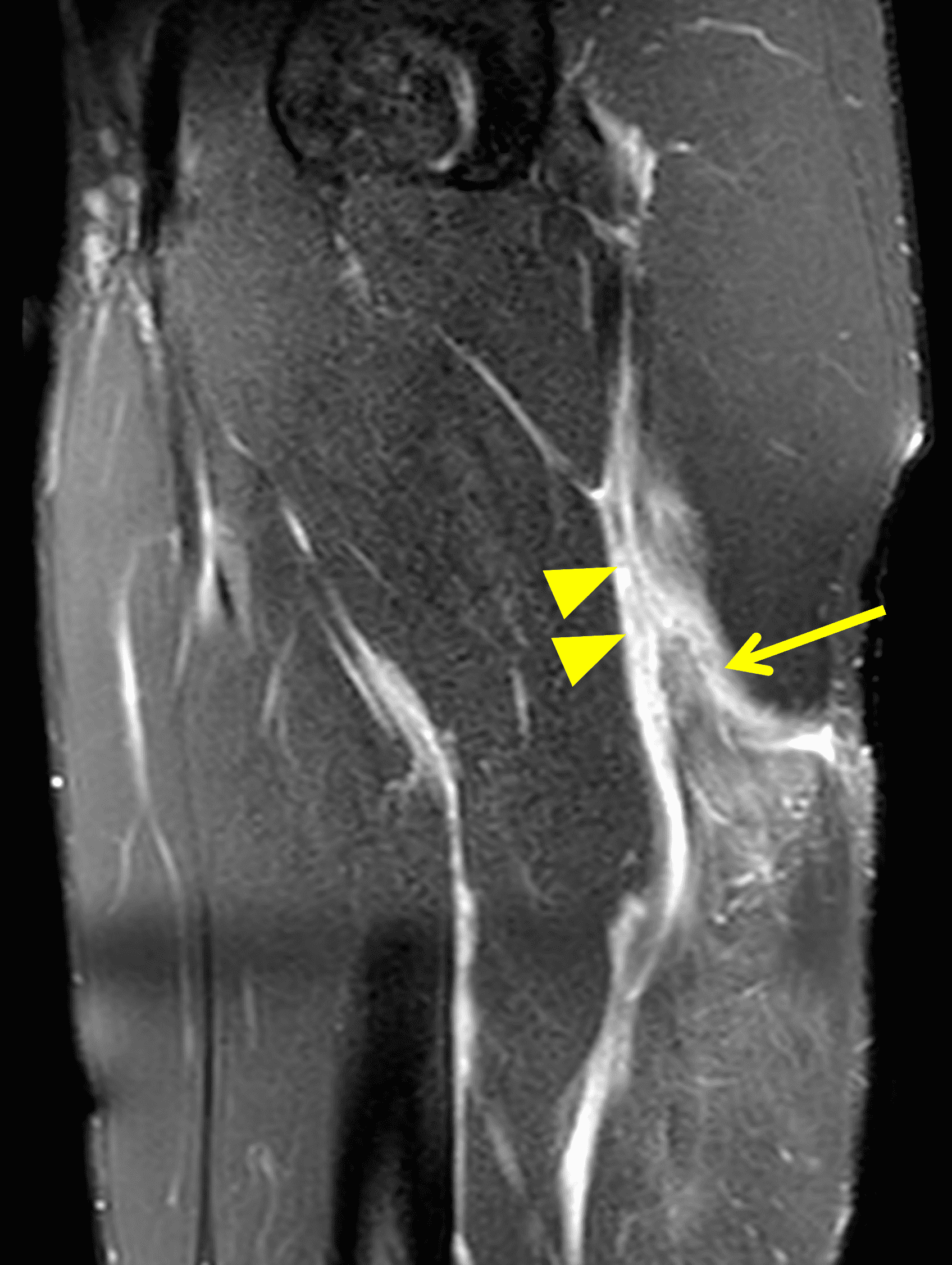 Grading Hamstring Injuries using the British Athletics Muscle Injury ...