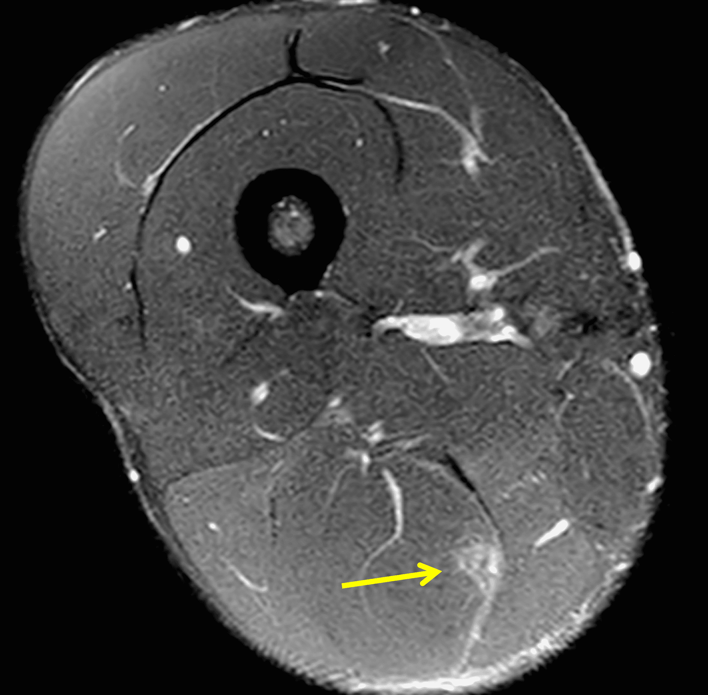 Grading Hamstring Injuries using the British Athletics Muscle Injury ...