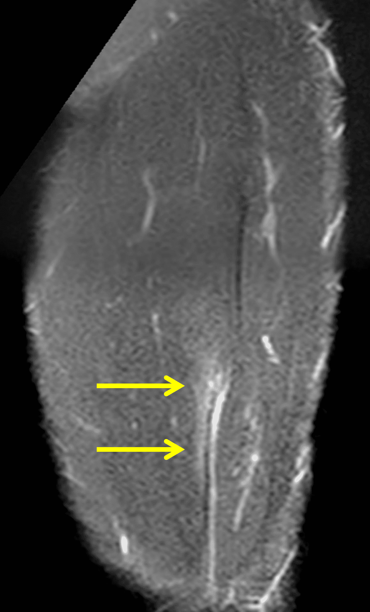 Grading Hamstring Injuries using the British Athletics Muscle Injury ...
