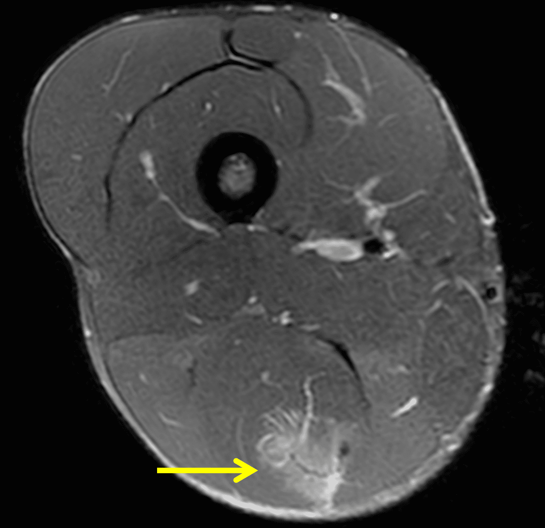 Grading Hamstring Injuries using the British Athletics Muscle Injury ...