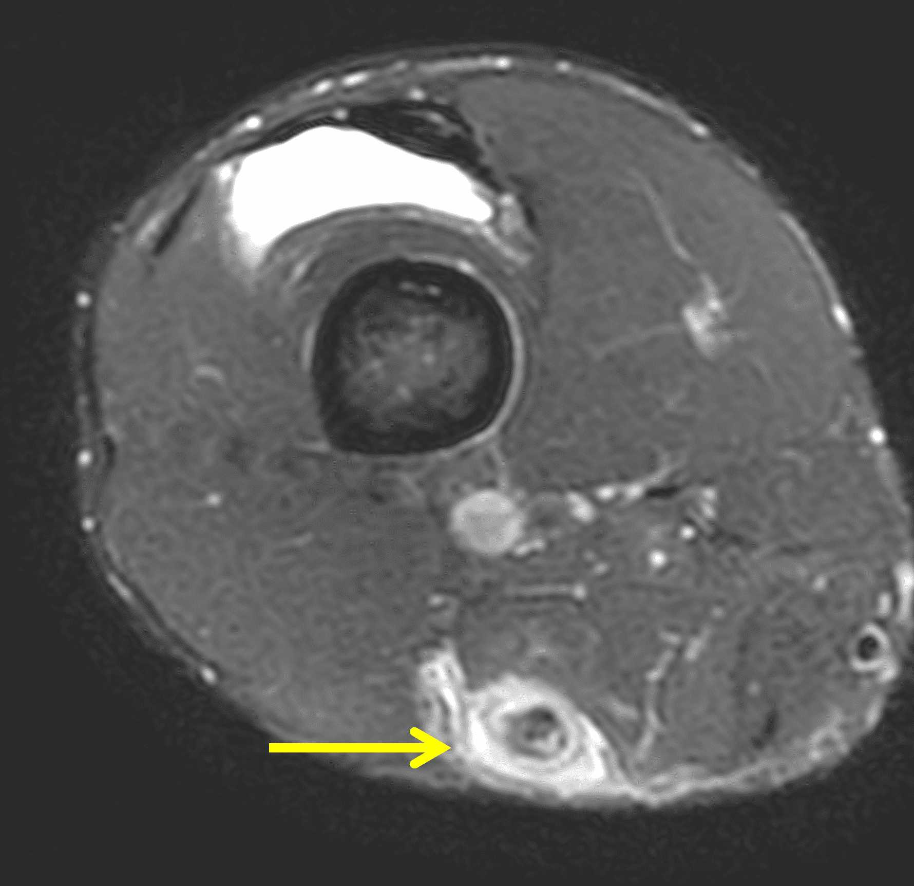 Grading Hamstring Injuries using the British Athletics Muscle Injury ...