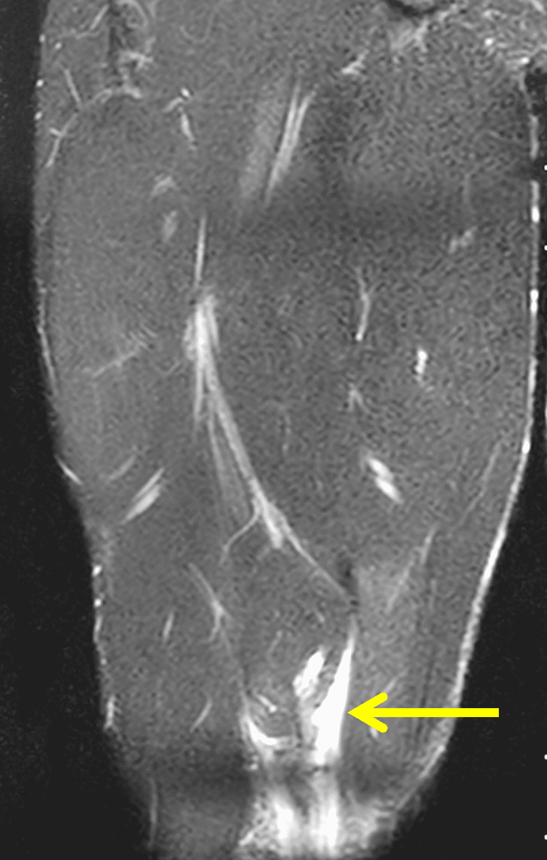 Grading Hamstring Injuries using the British Athletics Muscle Injury ...