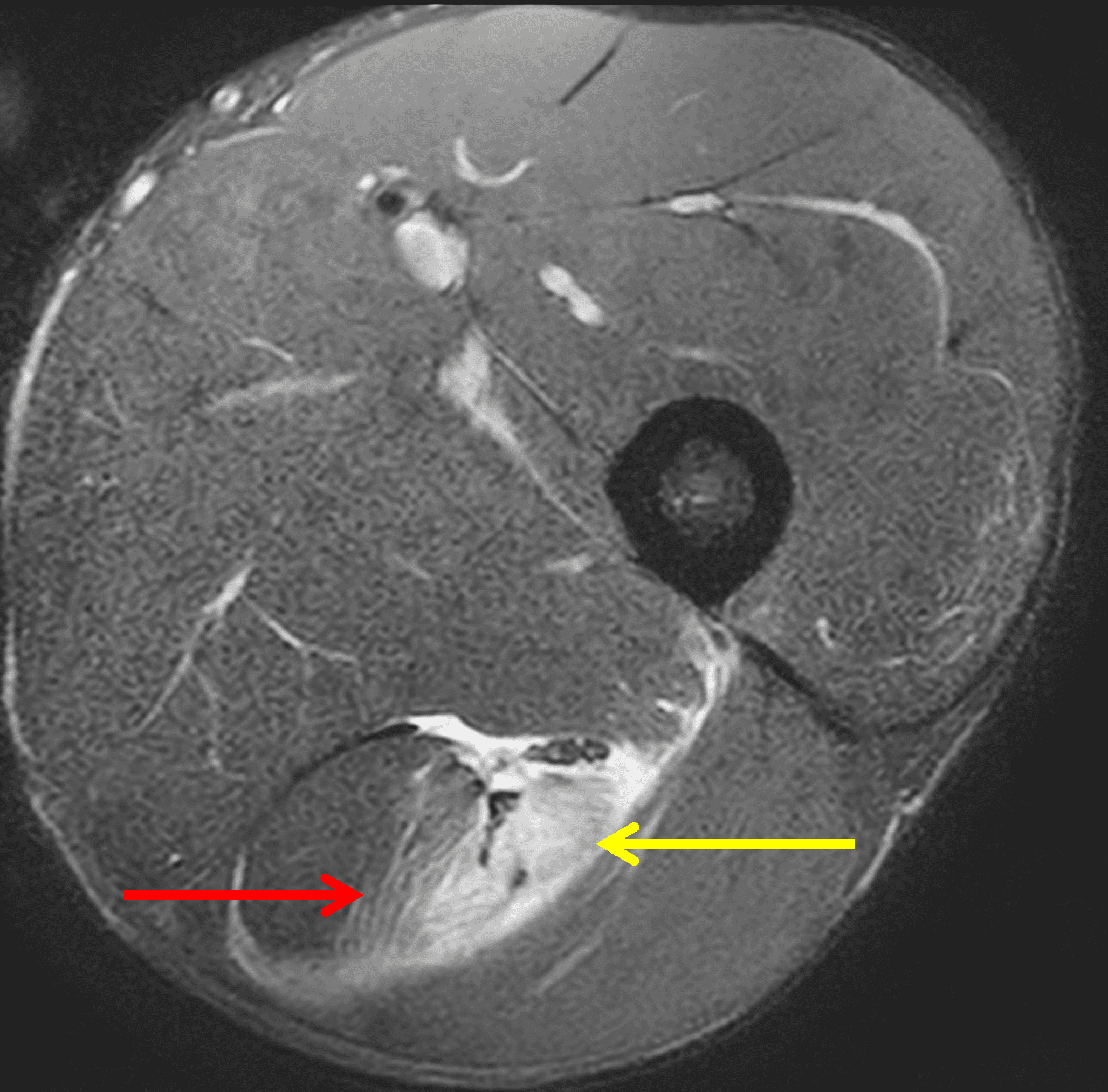 Grading Hamstring Injuries using the British Athletics Muscle Injury ...