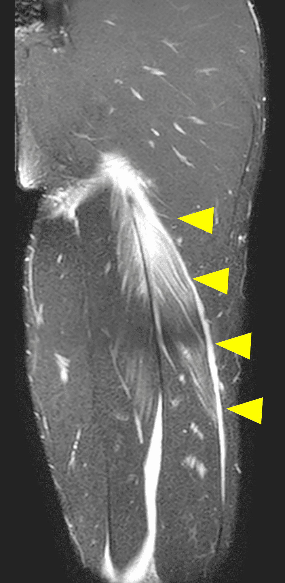 Grading Hamstring Injuries using the British Athletics Muscle Injury ...
