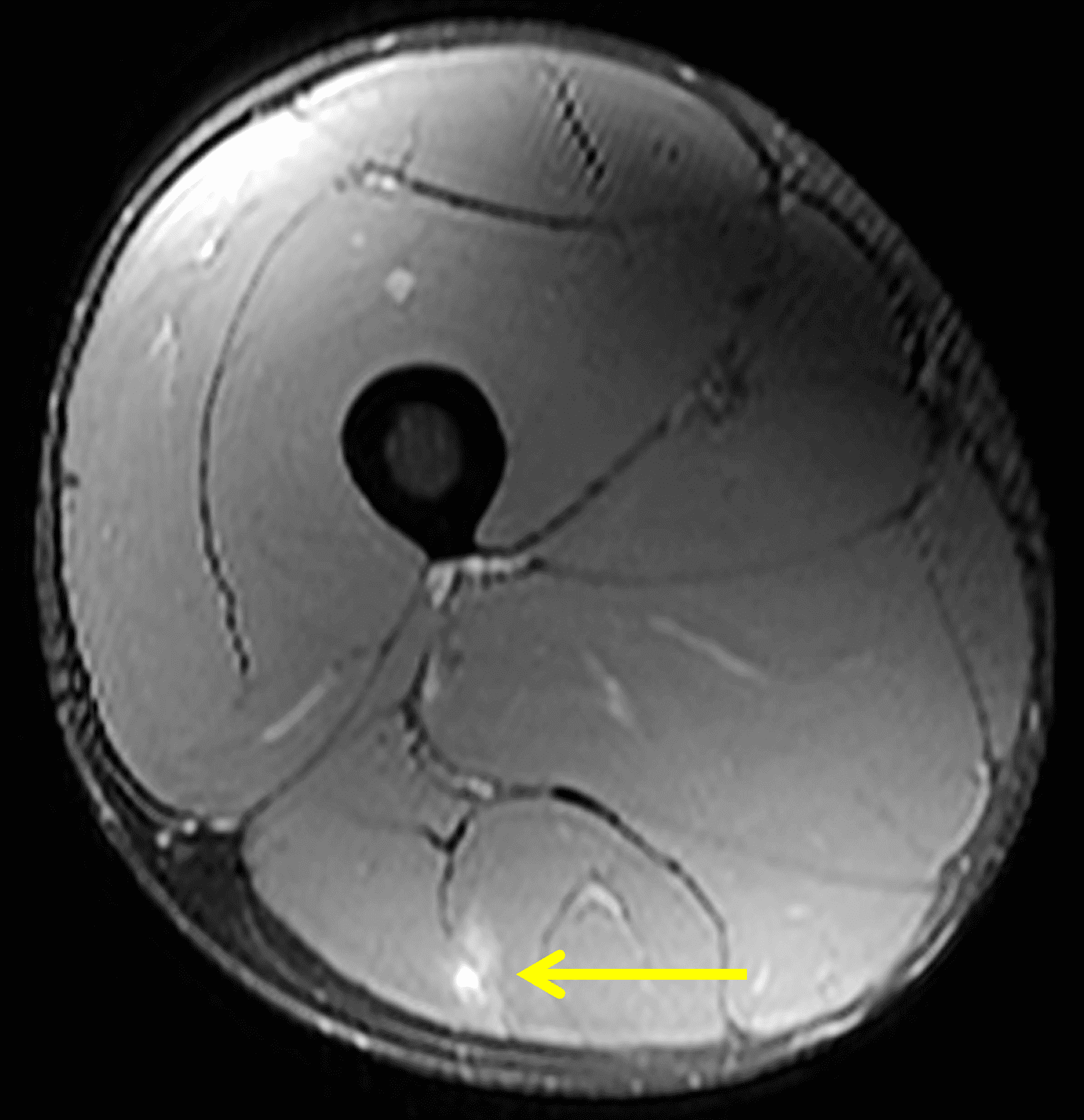 Grading Hamstring Injuries using the British Athletics Muscle Injury ...