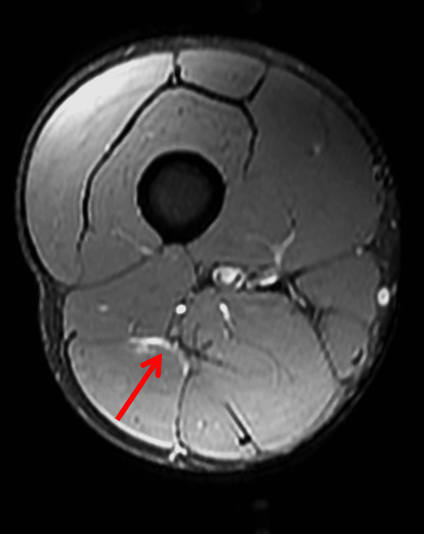 Grading Hamstring Injuries using the British Athletics Muscle Injury ...