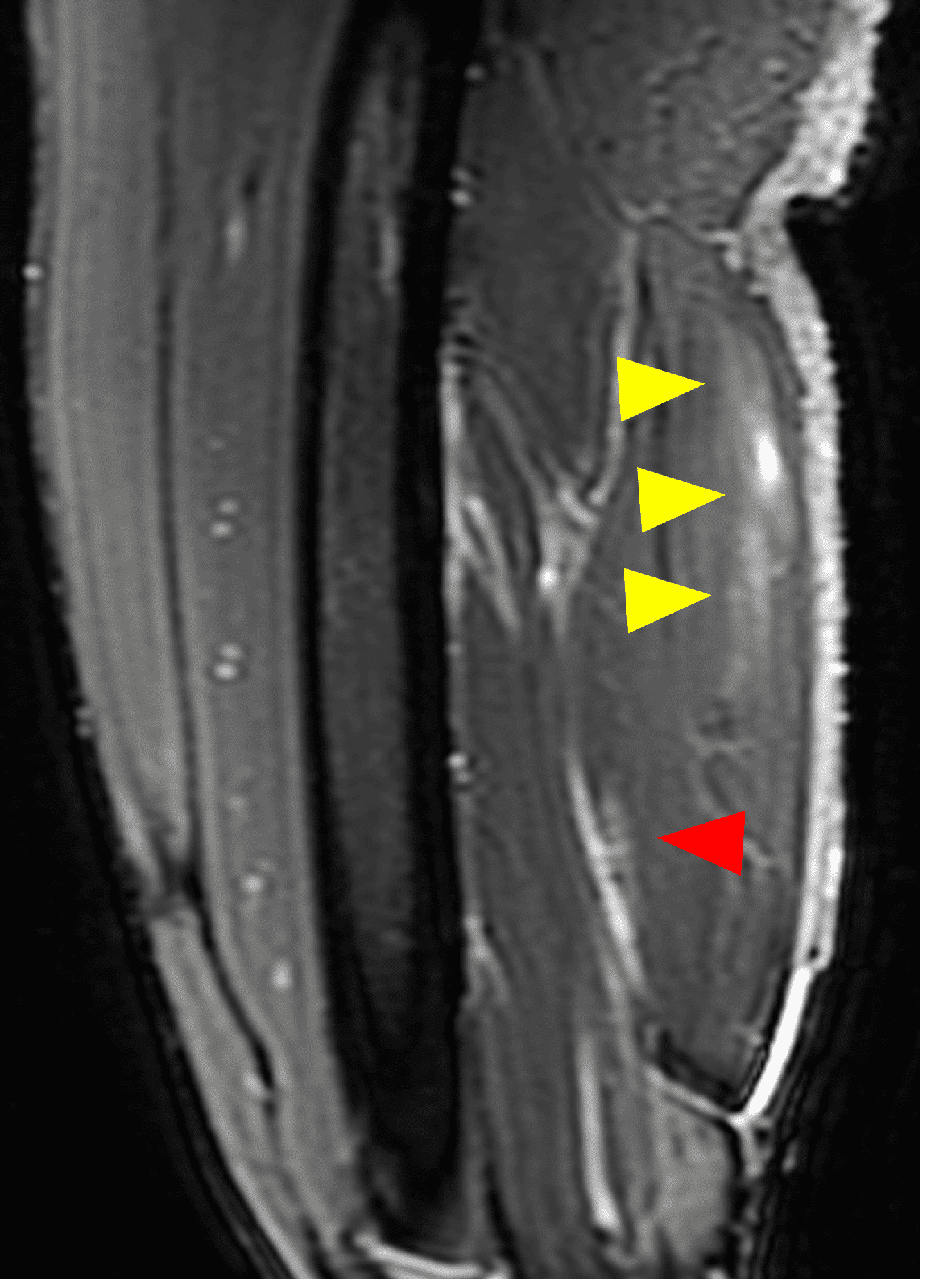 Grading Hamstring Injuries using the British Athletics Muscle Injury ...
