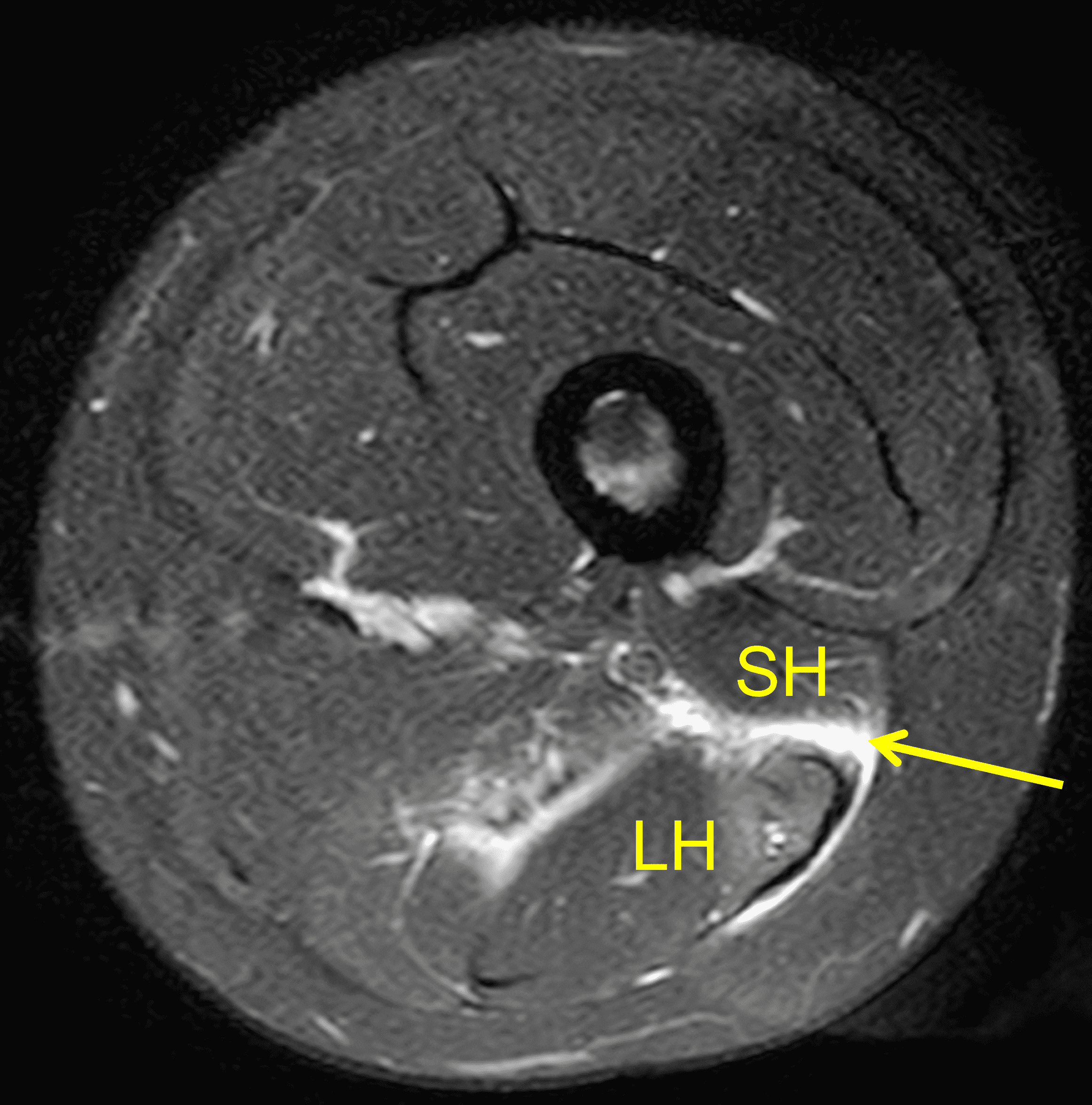 Grading Hamstring Injuries using the British Athletics Muscle Injury ...