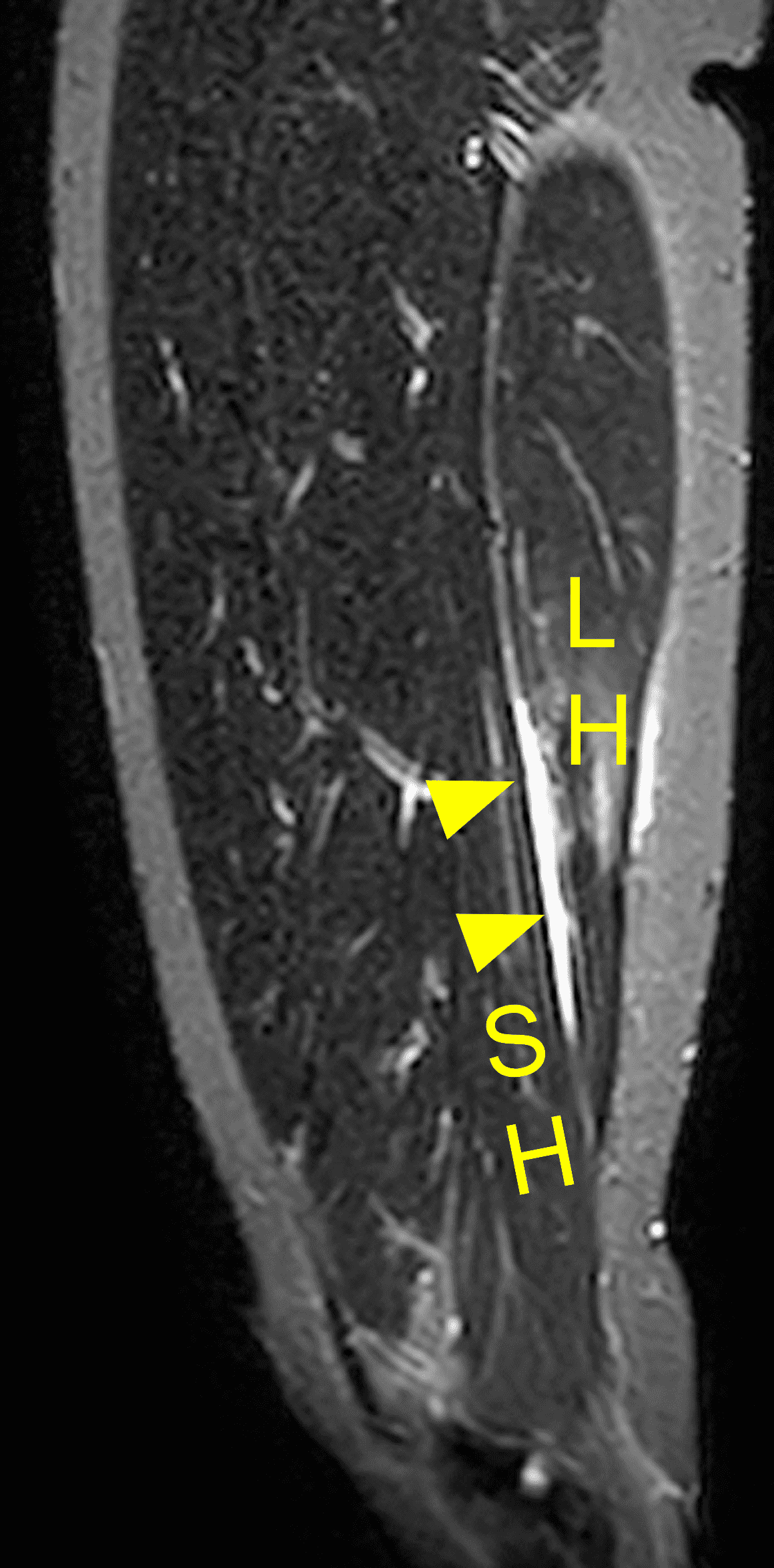 Grading Hamstring Injuries using the British Athletics Muscle Injury ...