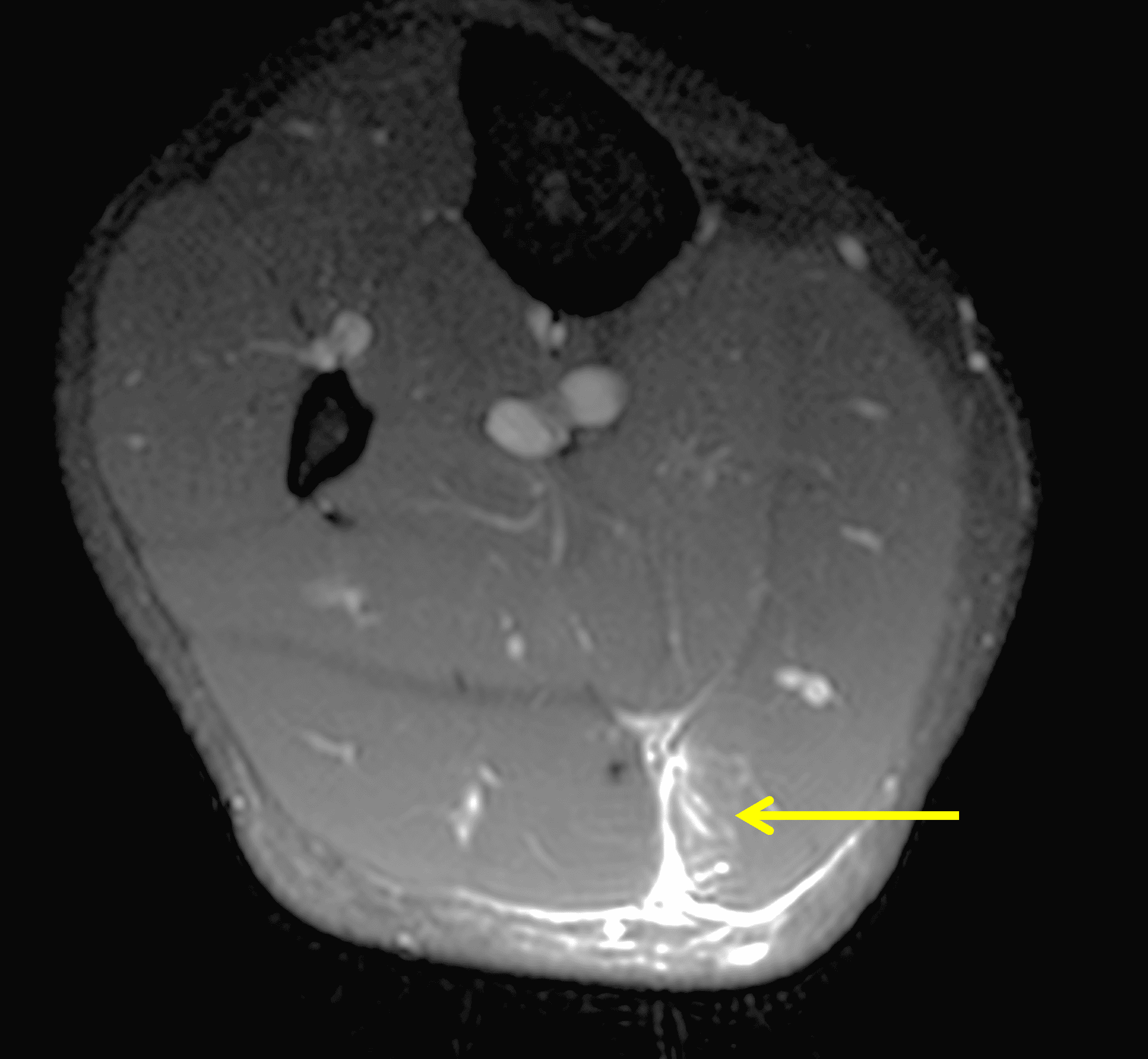 Grading Hamstring Injuries using the British Athletics Muscle Injury ...
