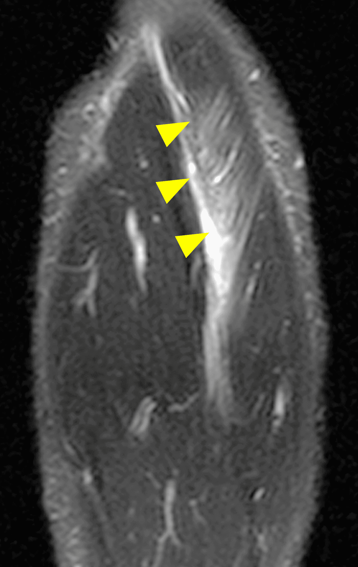 Grading Hamstring Injuries using the British Athletics Muscle Injury ...