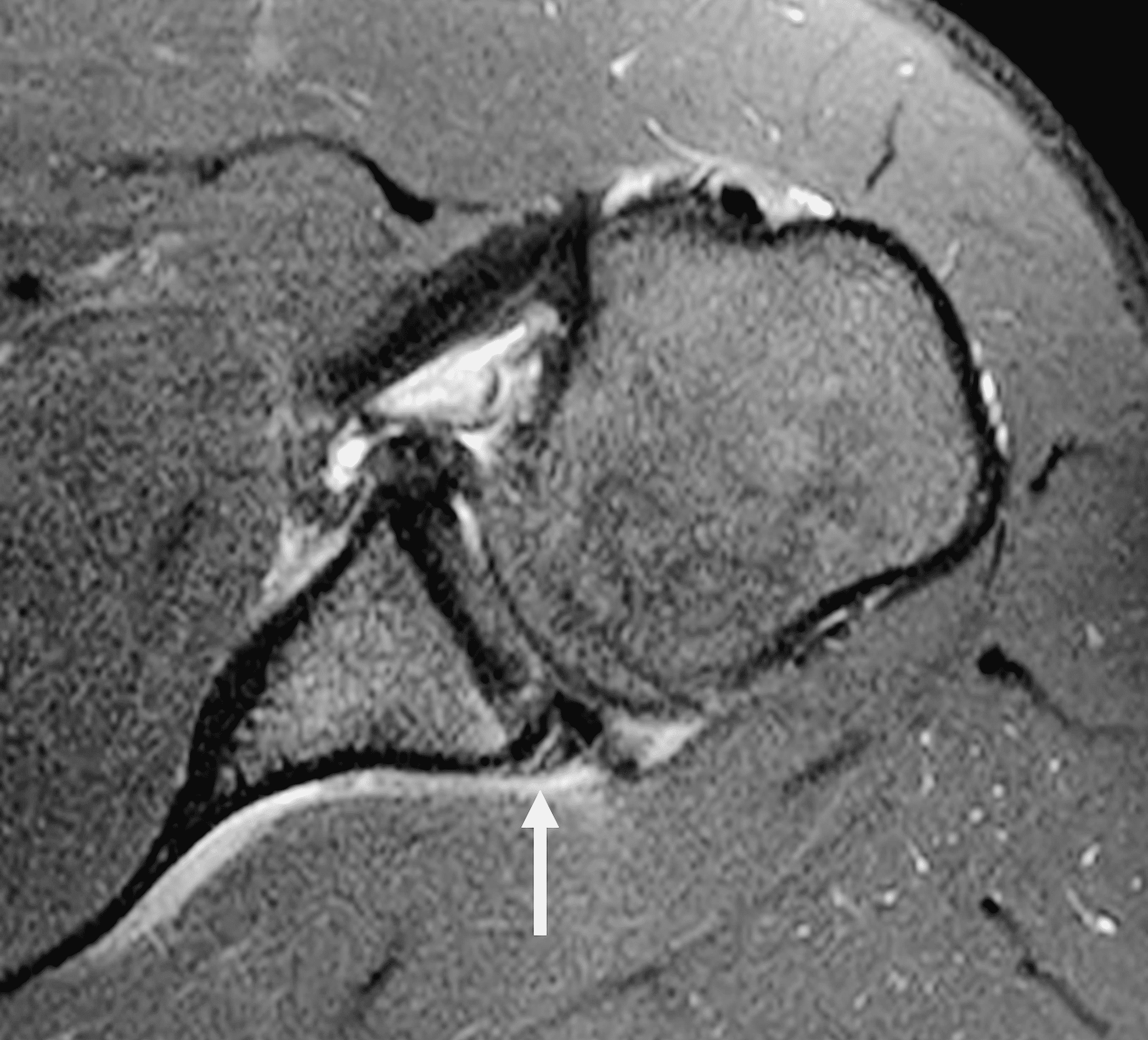 Batter's Shoulder | Radsource