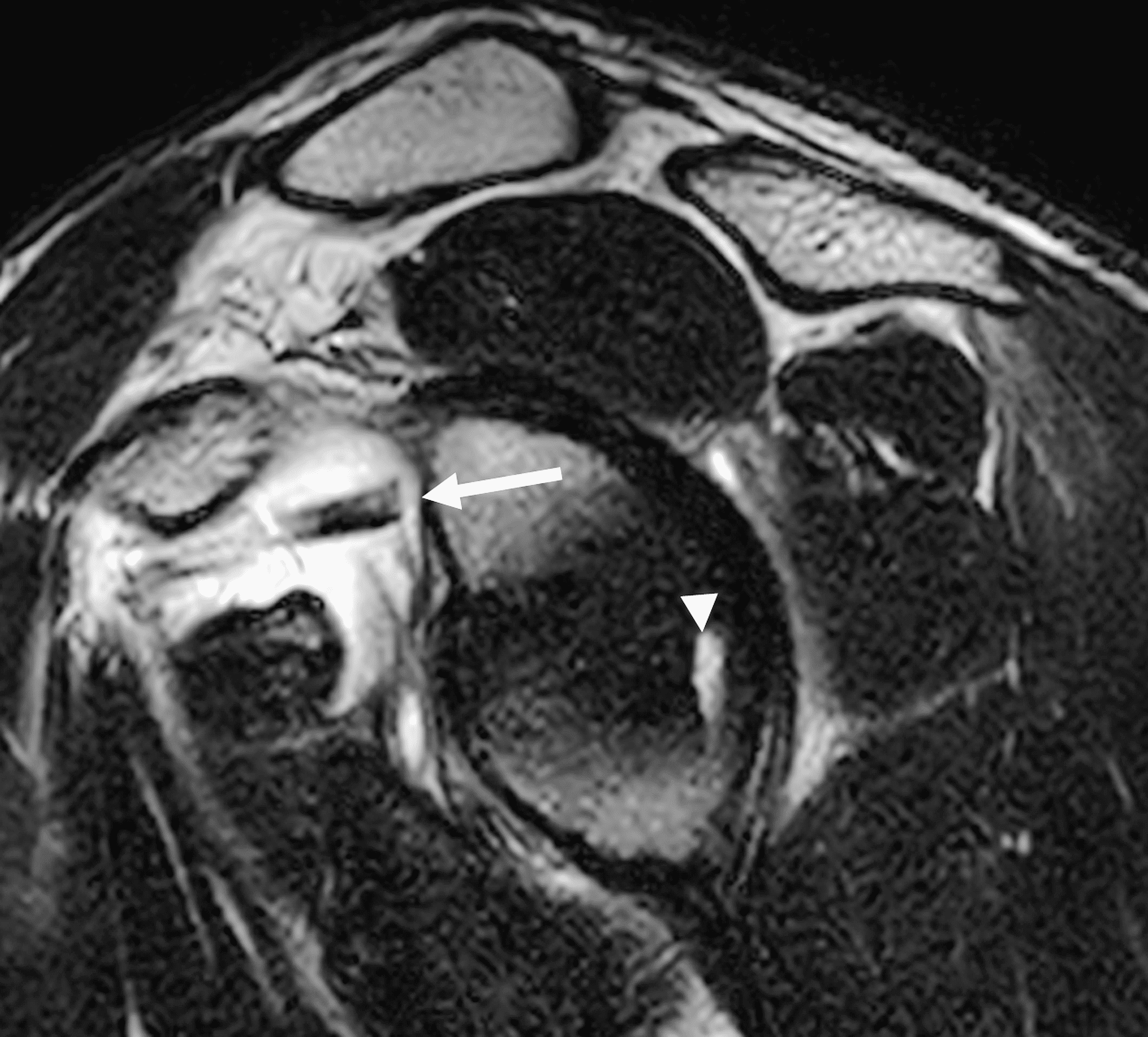 Batter's Shoulder | Radsource