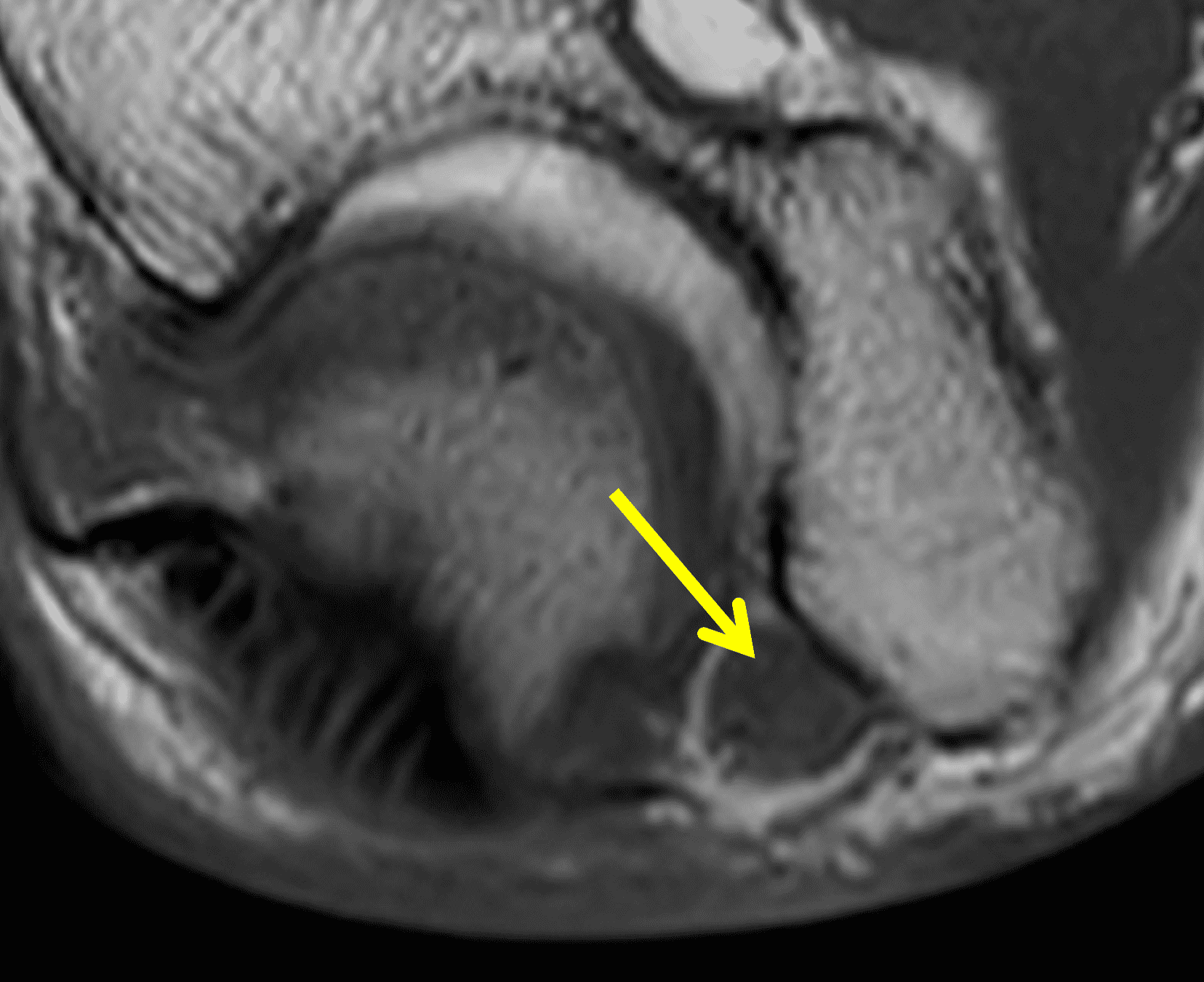 Cubital Tunnel Syndrome | Radsource