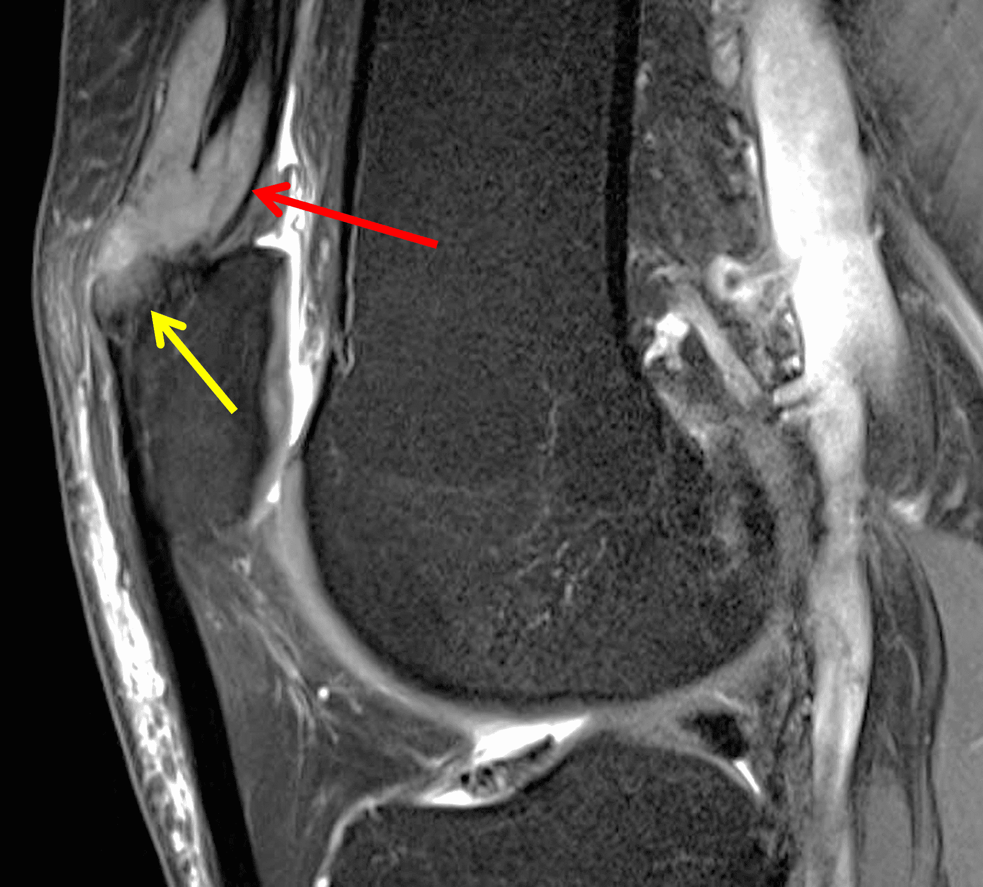 Intra-articular and Peri-articular Masses | Radsource