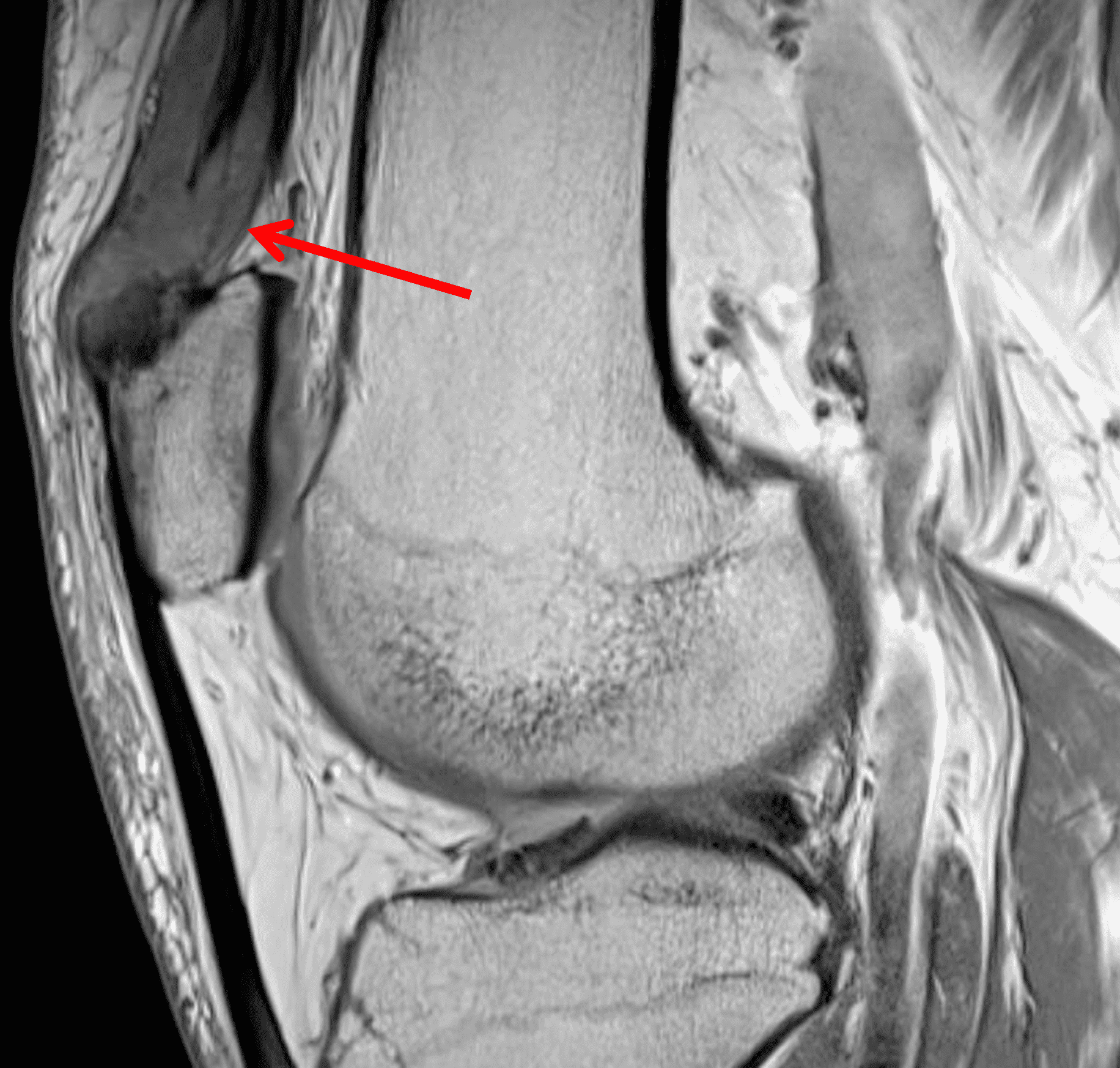 Intra-articular and Peri-articular Masses | Radsource