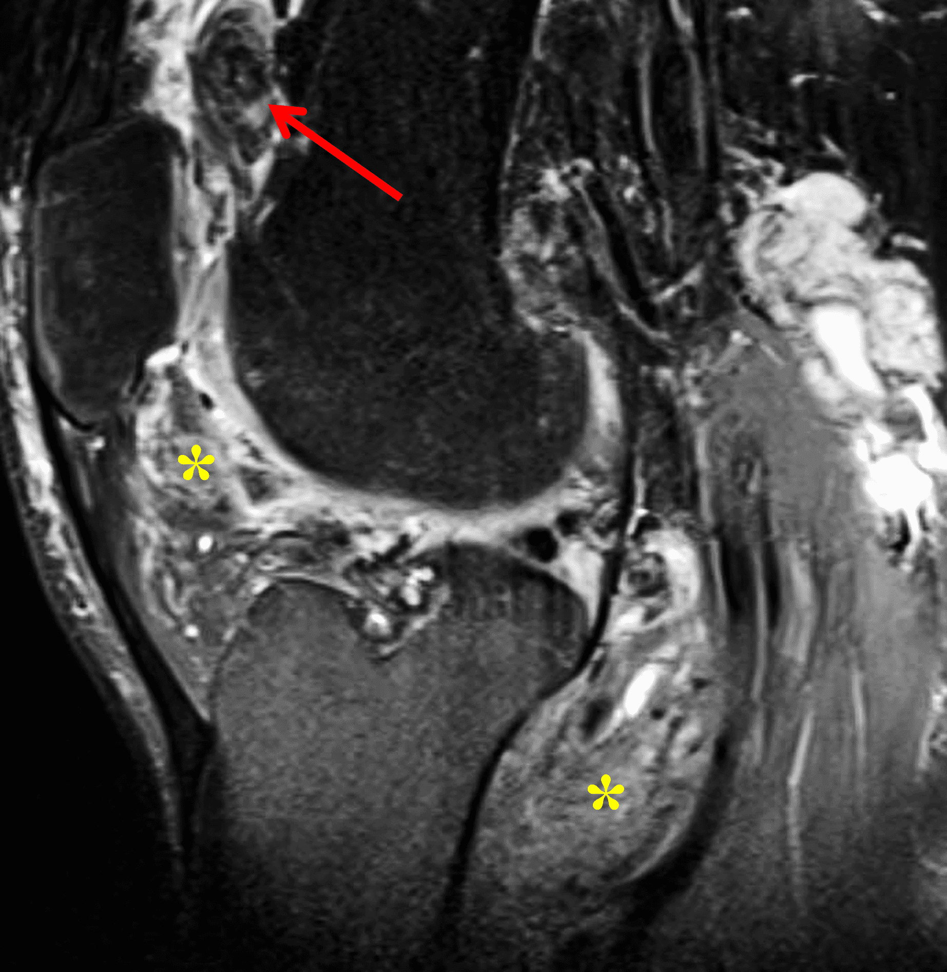 Intra-articular and Peri-articular Masses | Radsource