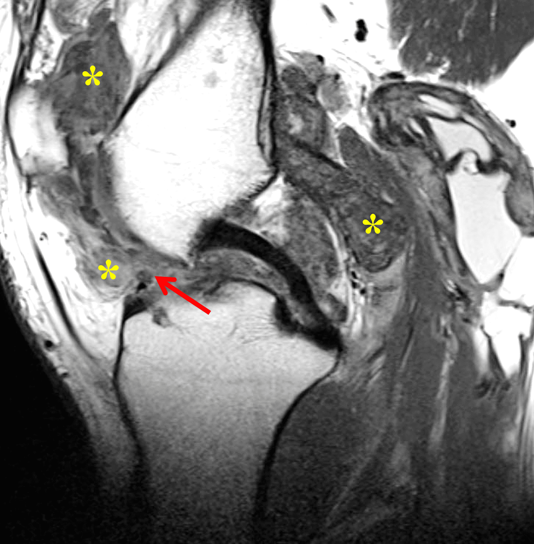 Intra-articular and Peri-articular Masses | Radsource