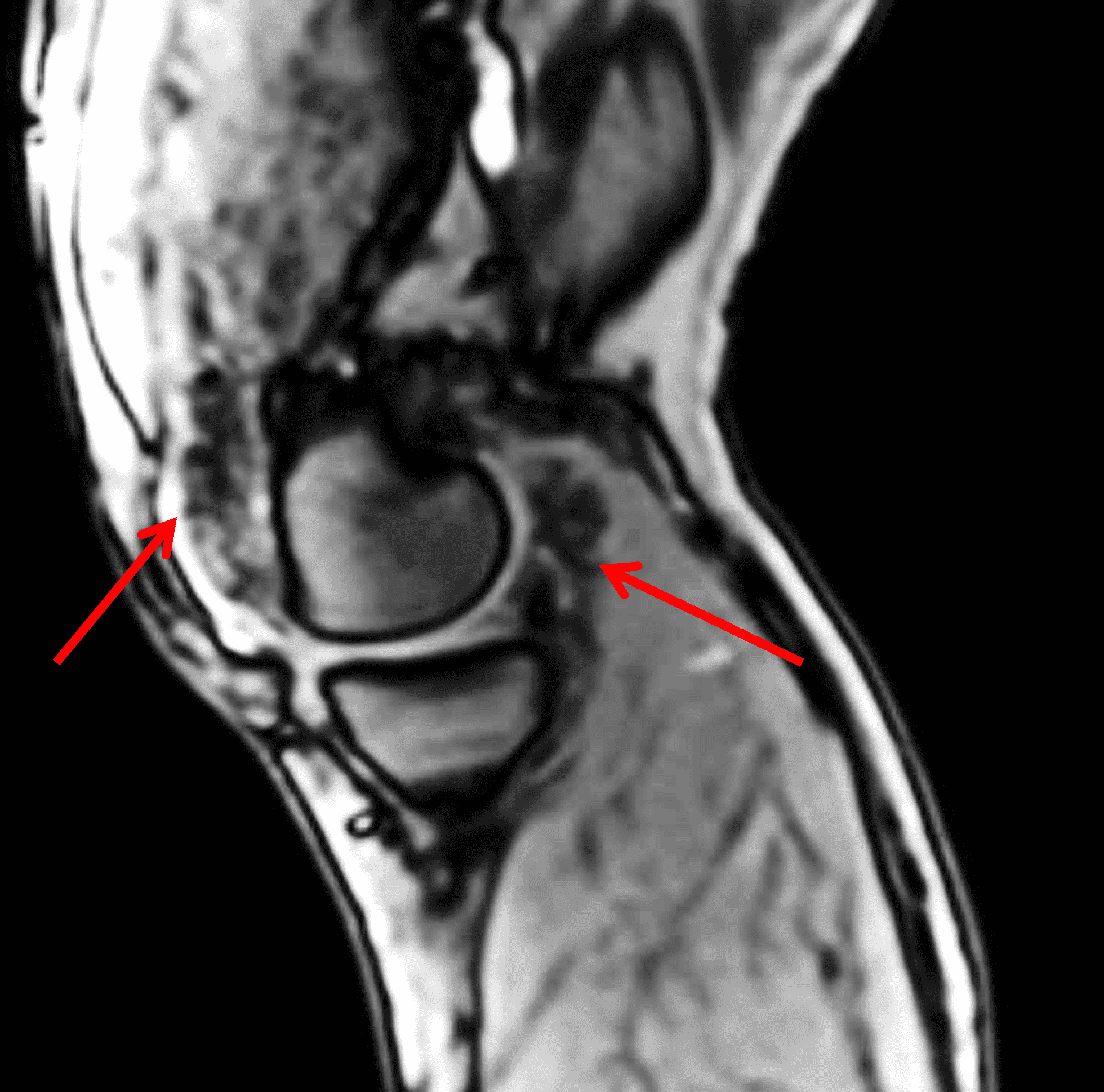 Intra-articular and Peri-articular Masses | Radsource