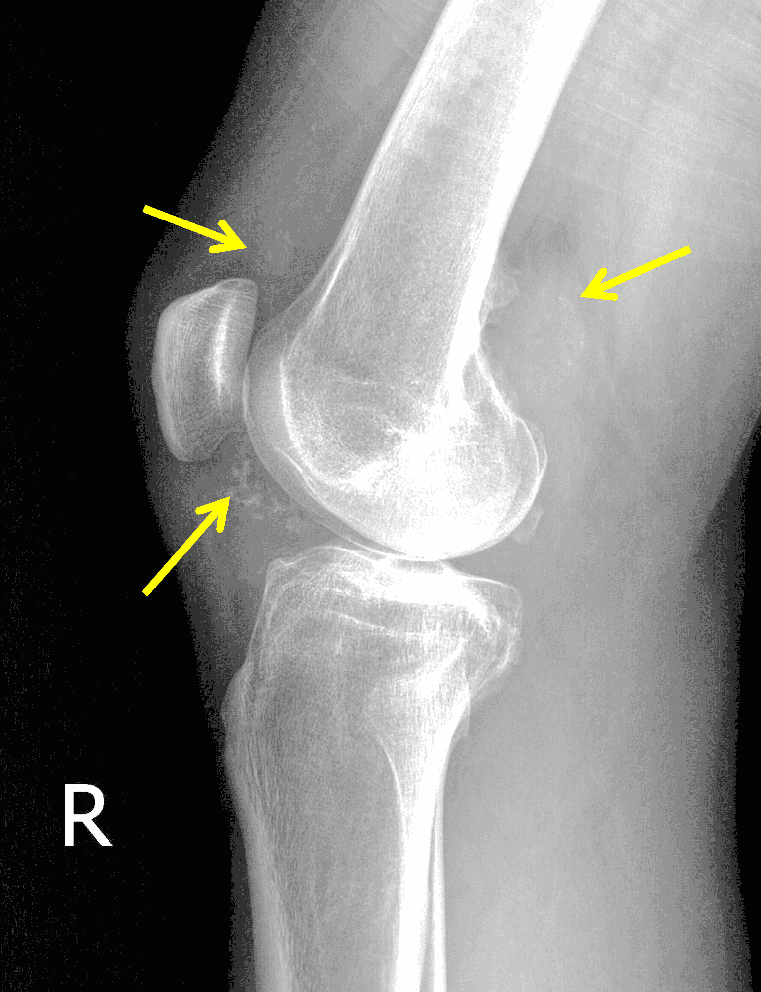 Intra-articular and Peri-articular Masses | Radsource