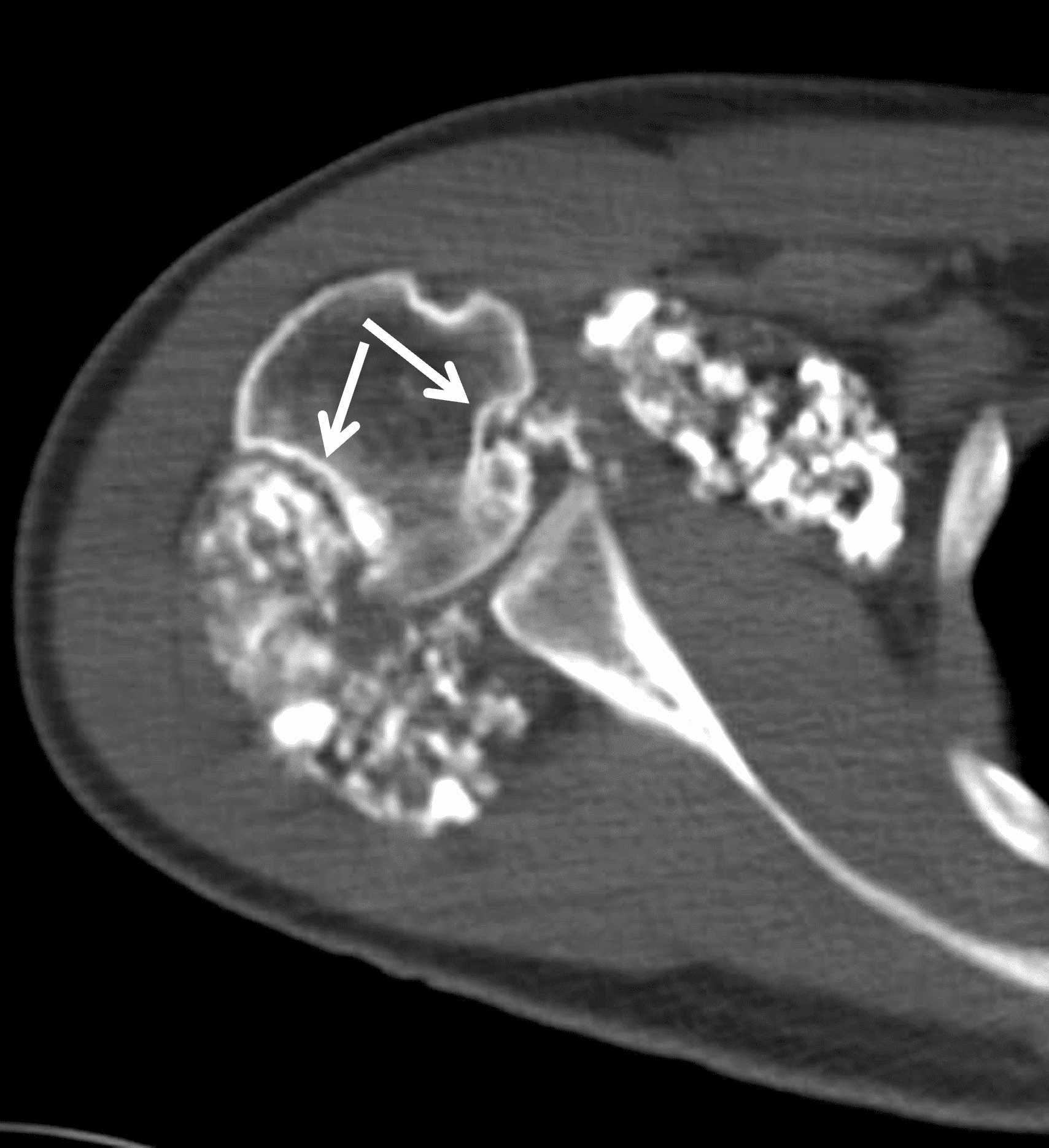 Intra-articular and Peri-articular Masses | Radsource